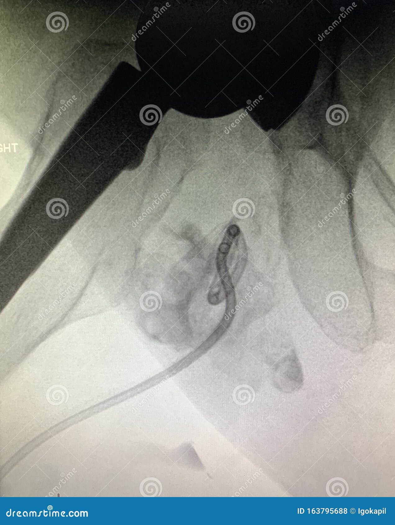 Ct Scan Pelvic Bone With Both Hip Joint 3d Rendering Image There Is No