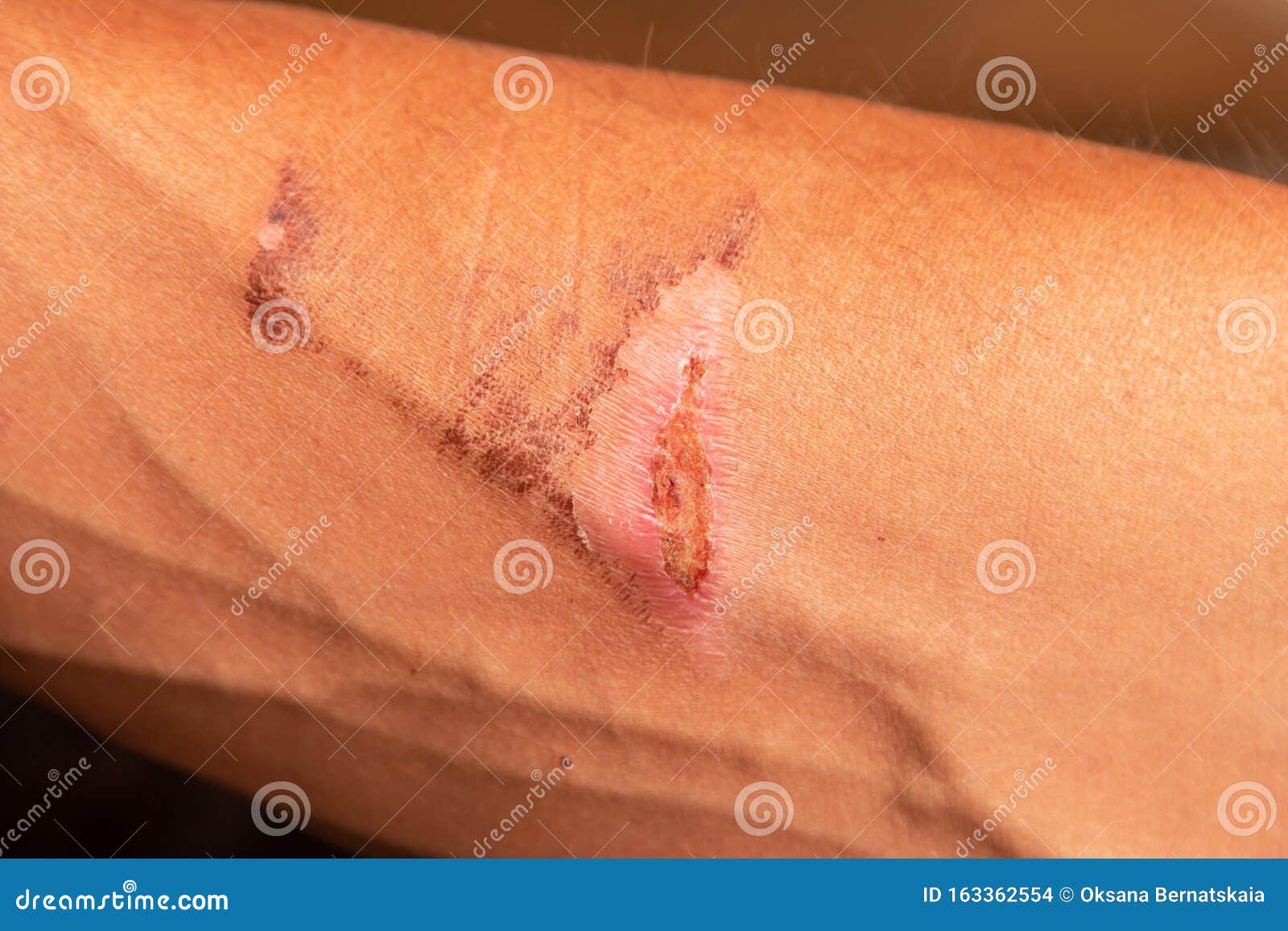Thermal burn on the skin stock photo. Image of damage - 163362554