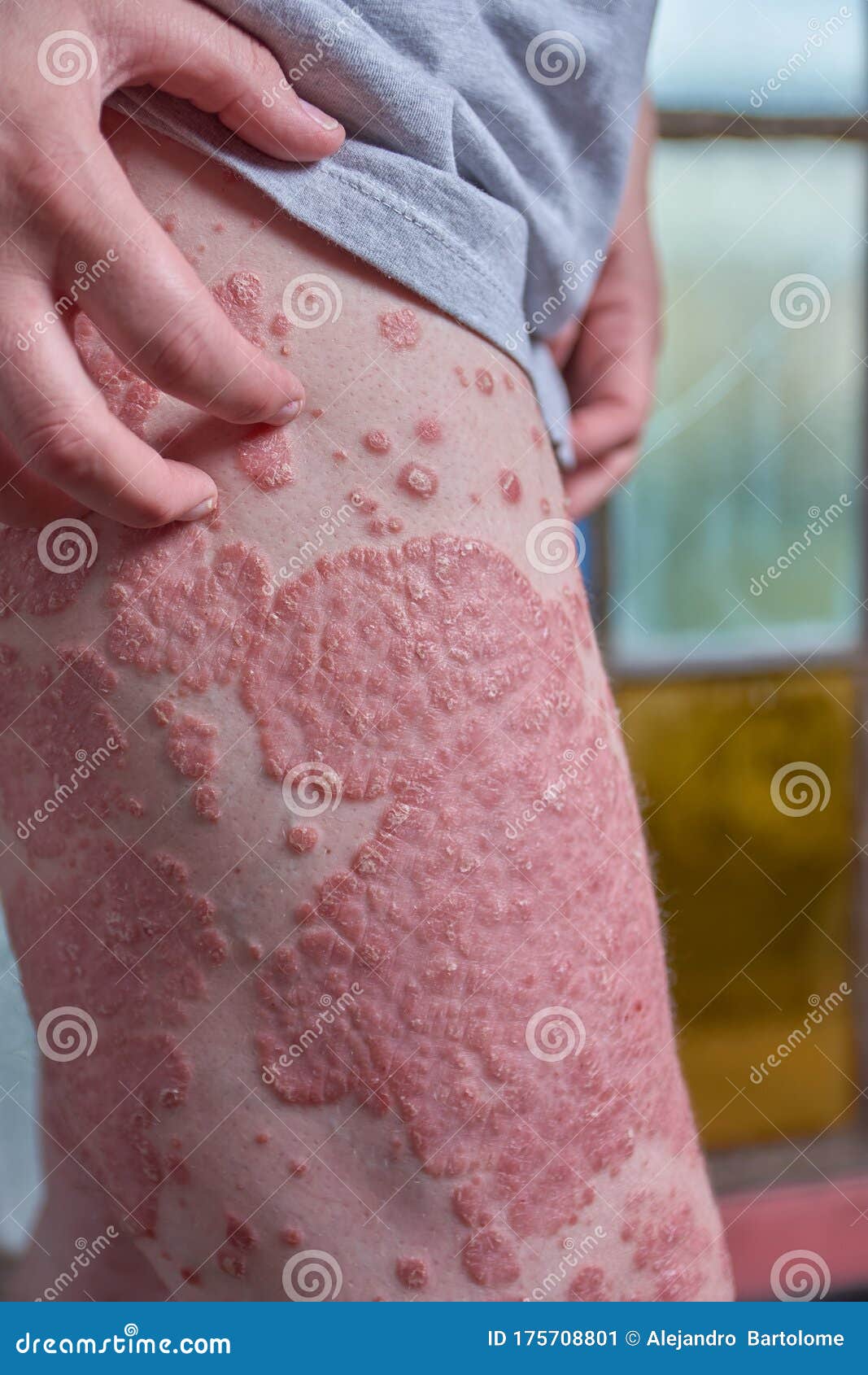 Thigh view with Psoriasis stock image. Image of closeup - 175708801