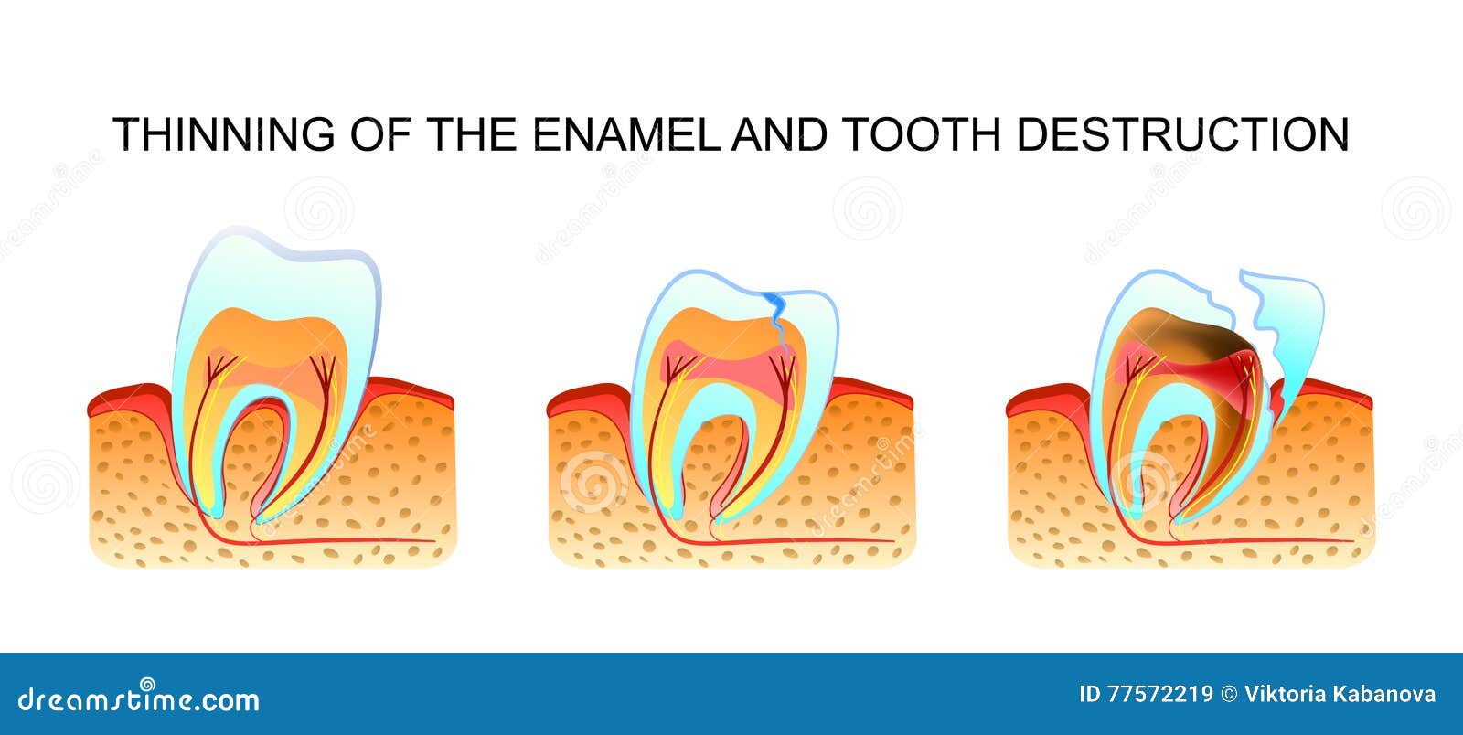 Thinning of the Enamel and Tooth Destruction Stock Vector ...