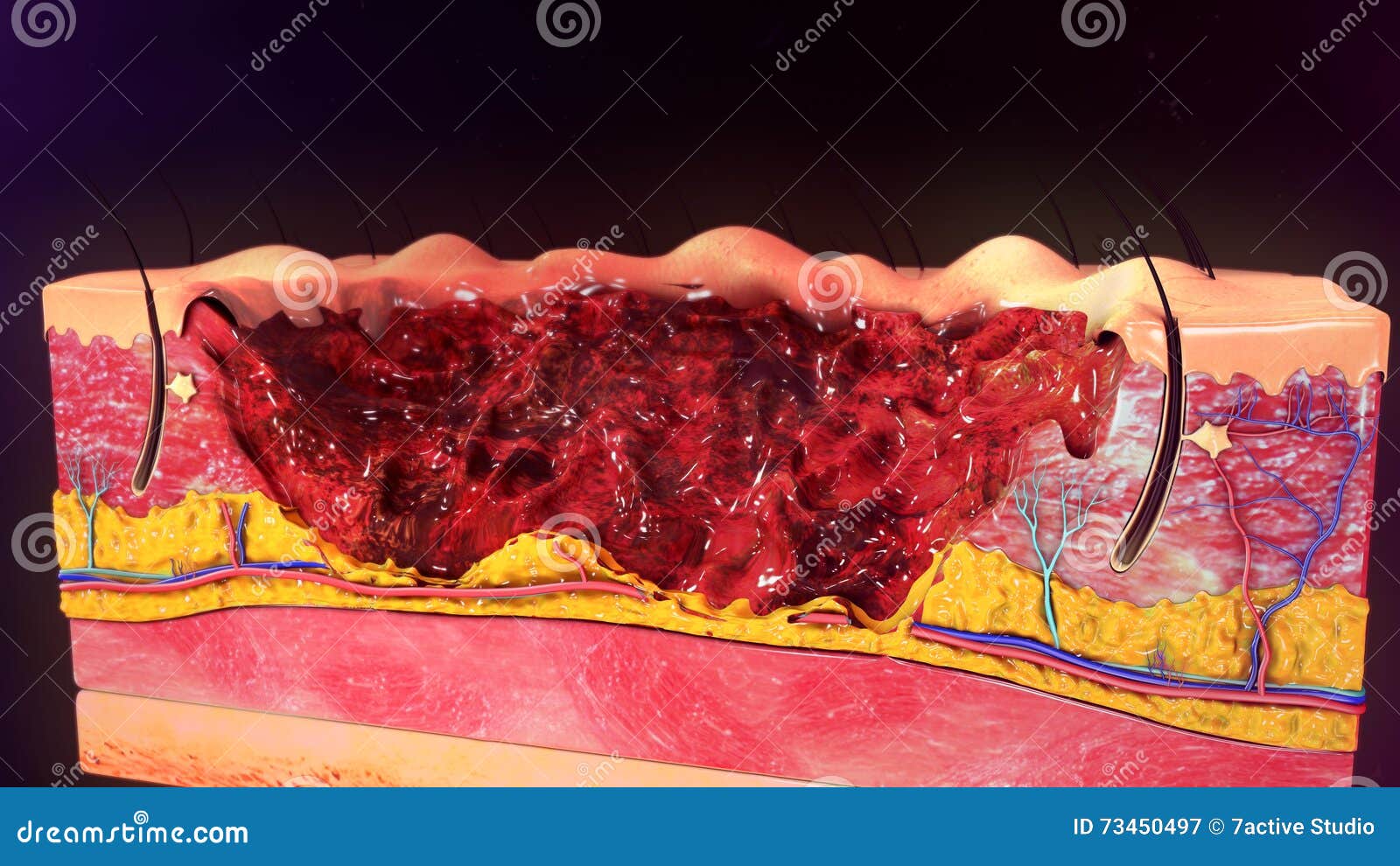 Third Degree Burn Stock Image Image Of Second Entire 73450497