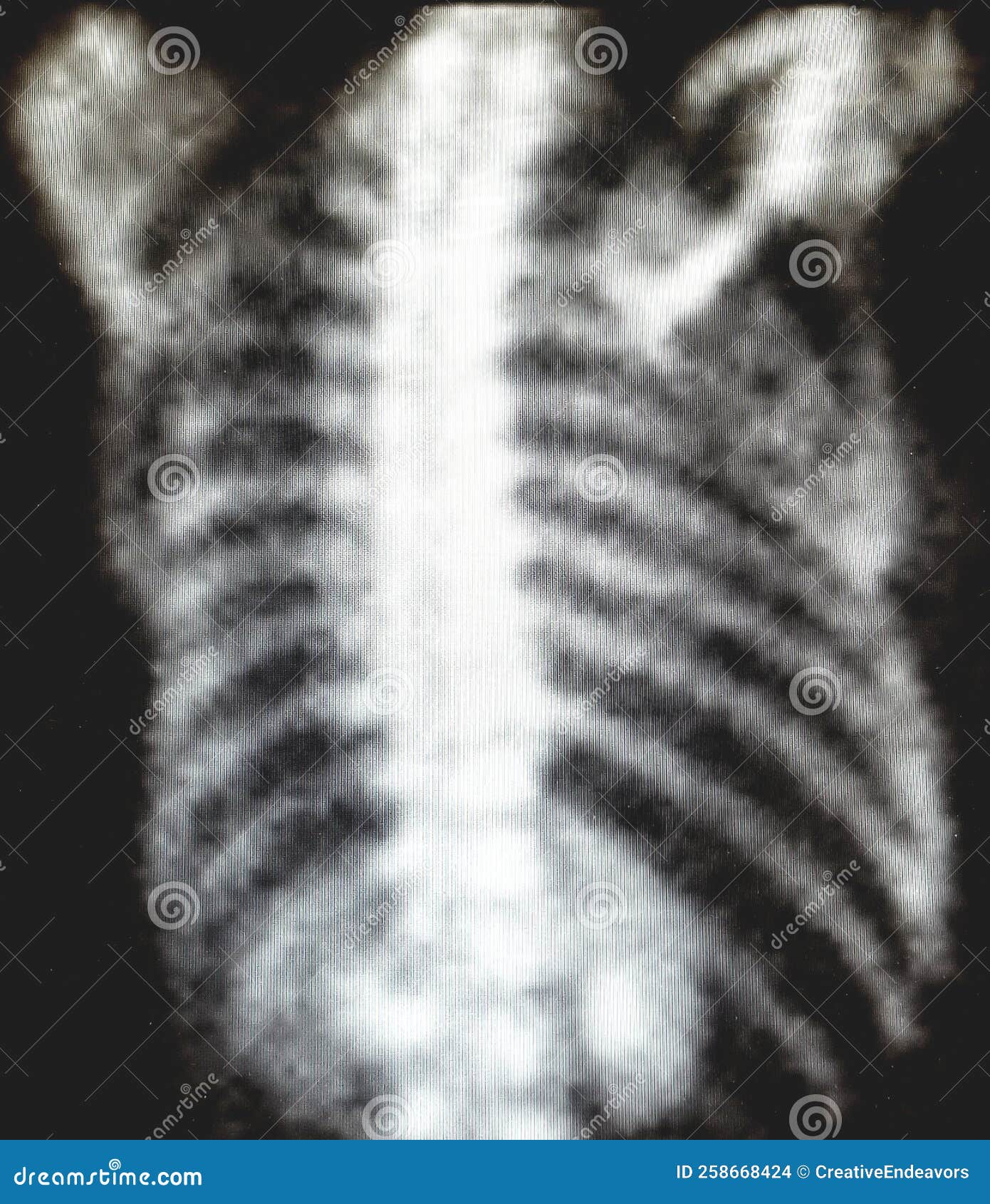 Thoracic Nuclear Medicine Bone Scan - Normal Image Stock Photo - Image ...