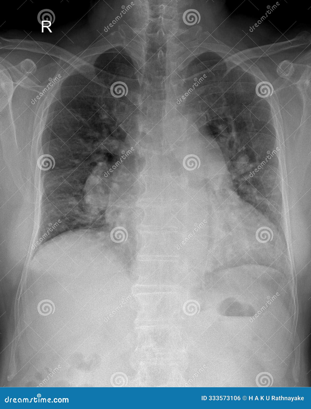 Thoracic Cavity X-Ray: Diagnosing Heart, Lung, and Ribcage Issues Stock ...