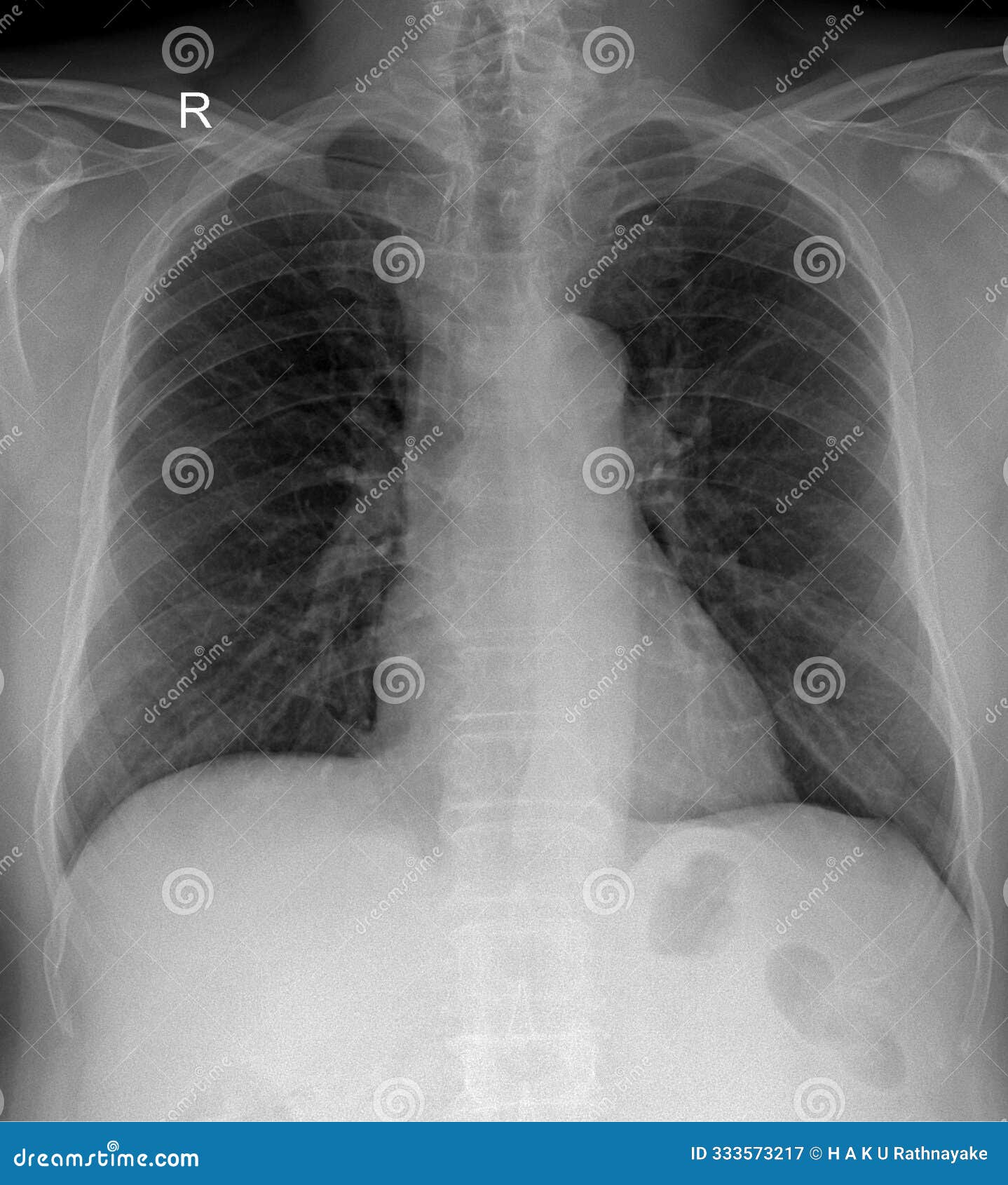 Thoracic Cavity Imaging: How X-Rays Help Diagnose Respiratory Disorders ...