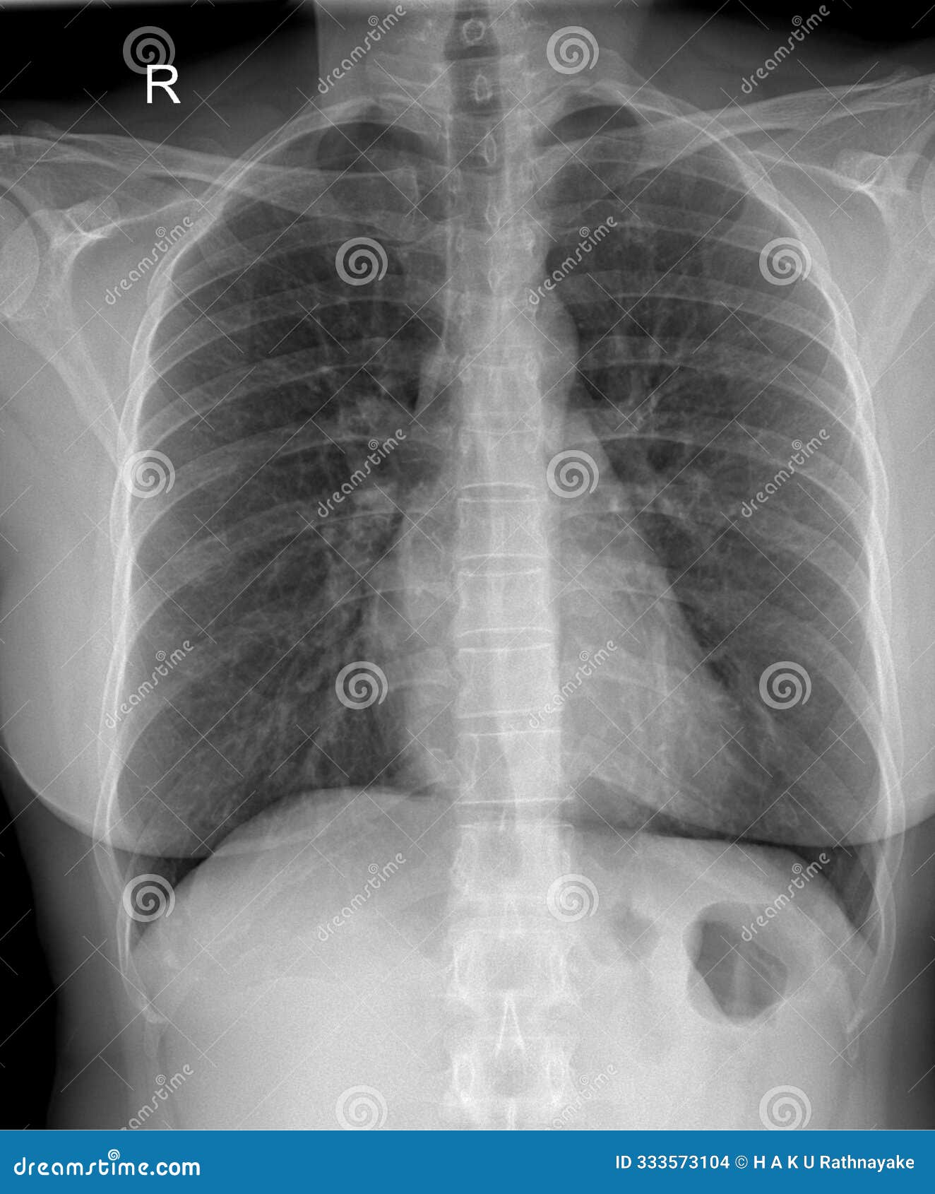 Thoracic Cavity X-Ray: Diagnosing Heart, Lung, And Ribcage Issues ...