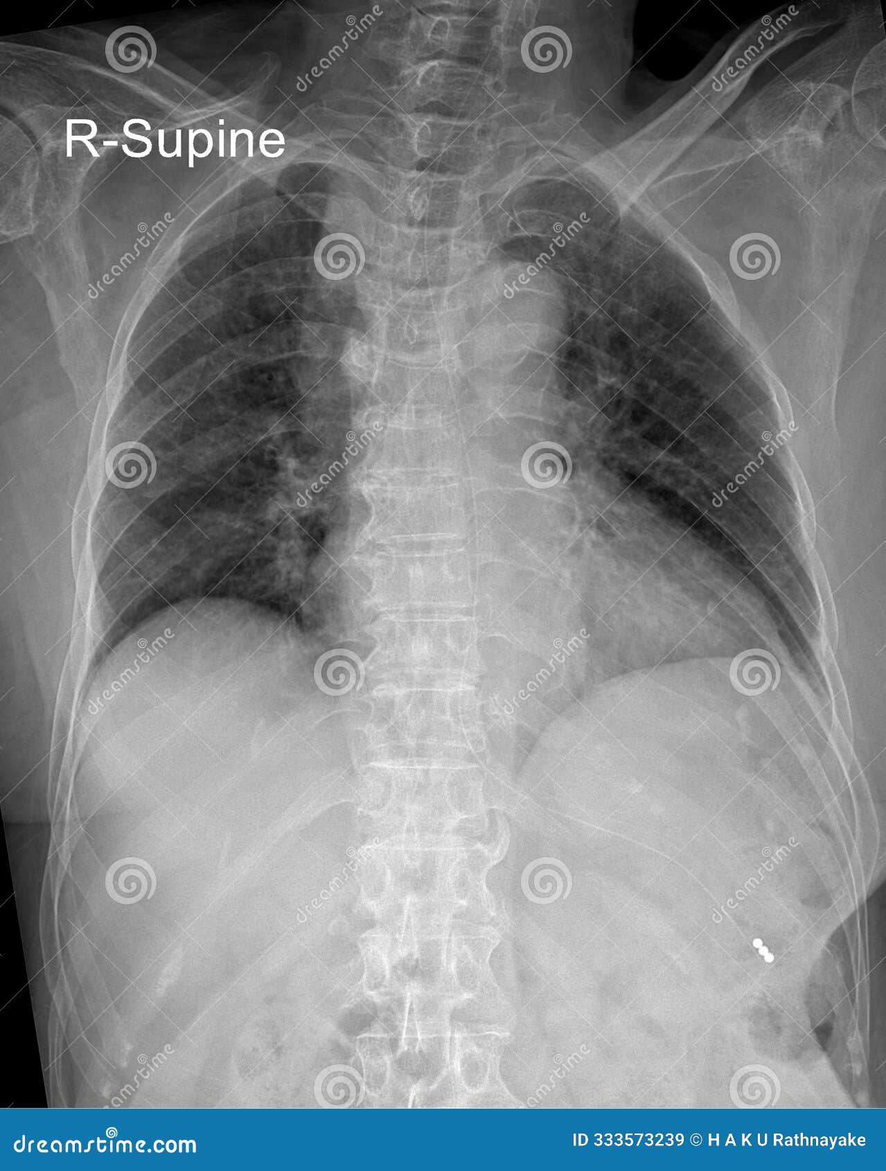 Thoracic Cavity X-Ray: Diagnosing Heart, Lung, And Ribcage Issues ...
