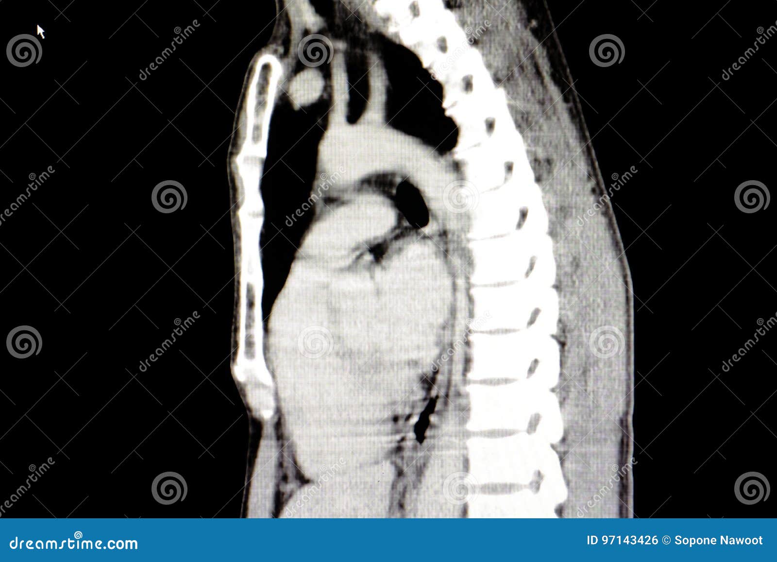 Thoracic CT stock photo. Image of xray, film, scan, radiation - 97143426