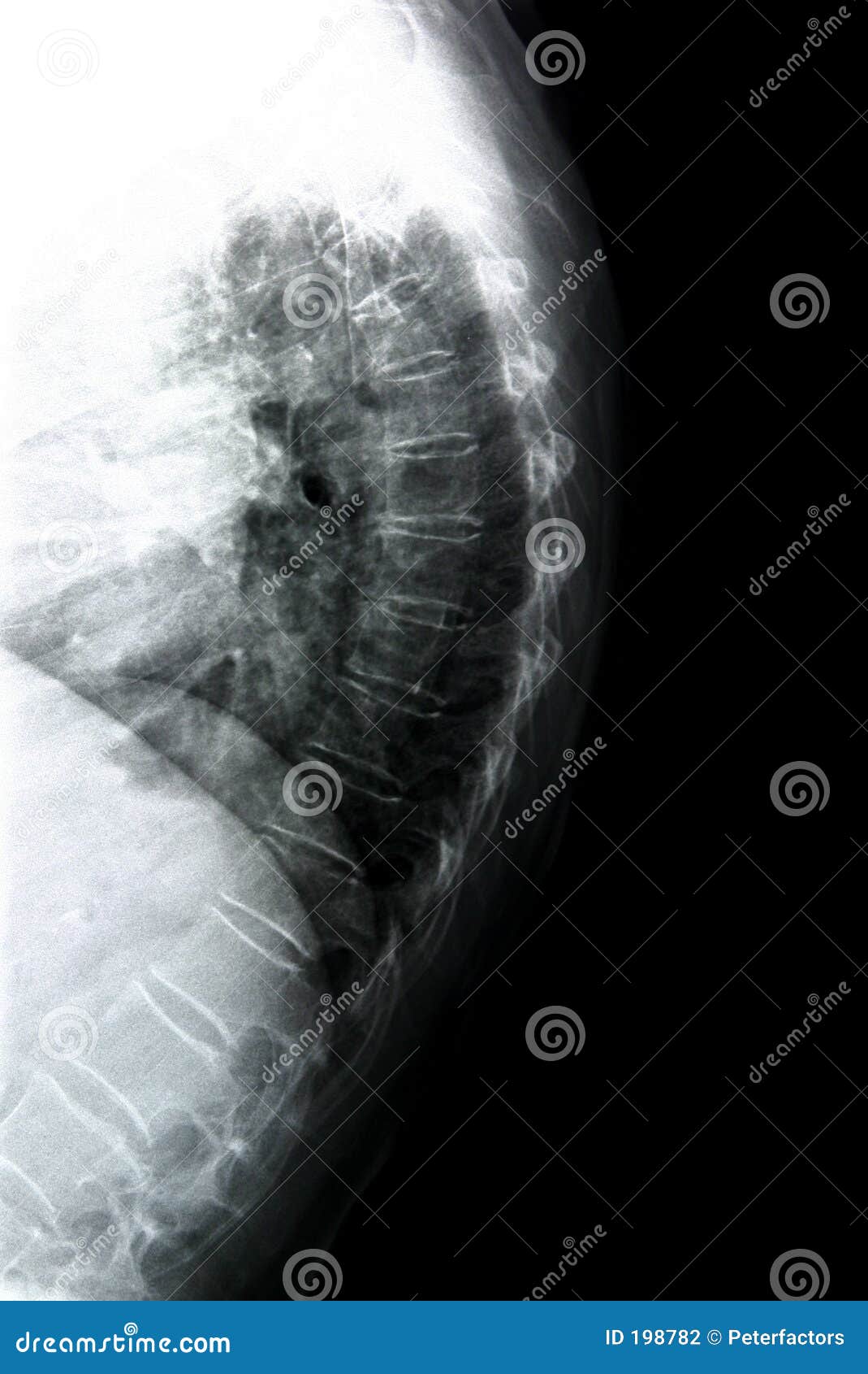 X-ray Thoracic Spine Fracture Radiograph Of Thoracic And Lumbar Spine ...