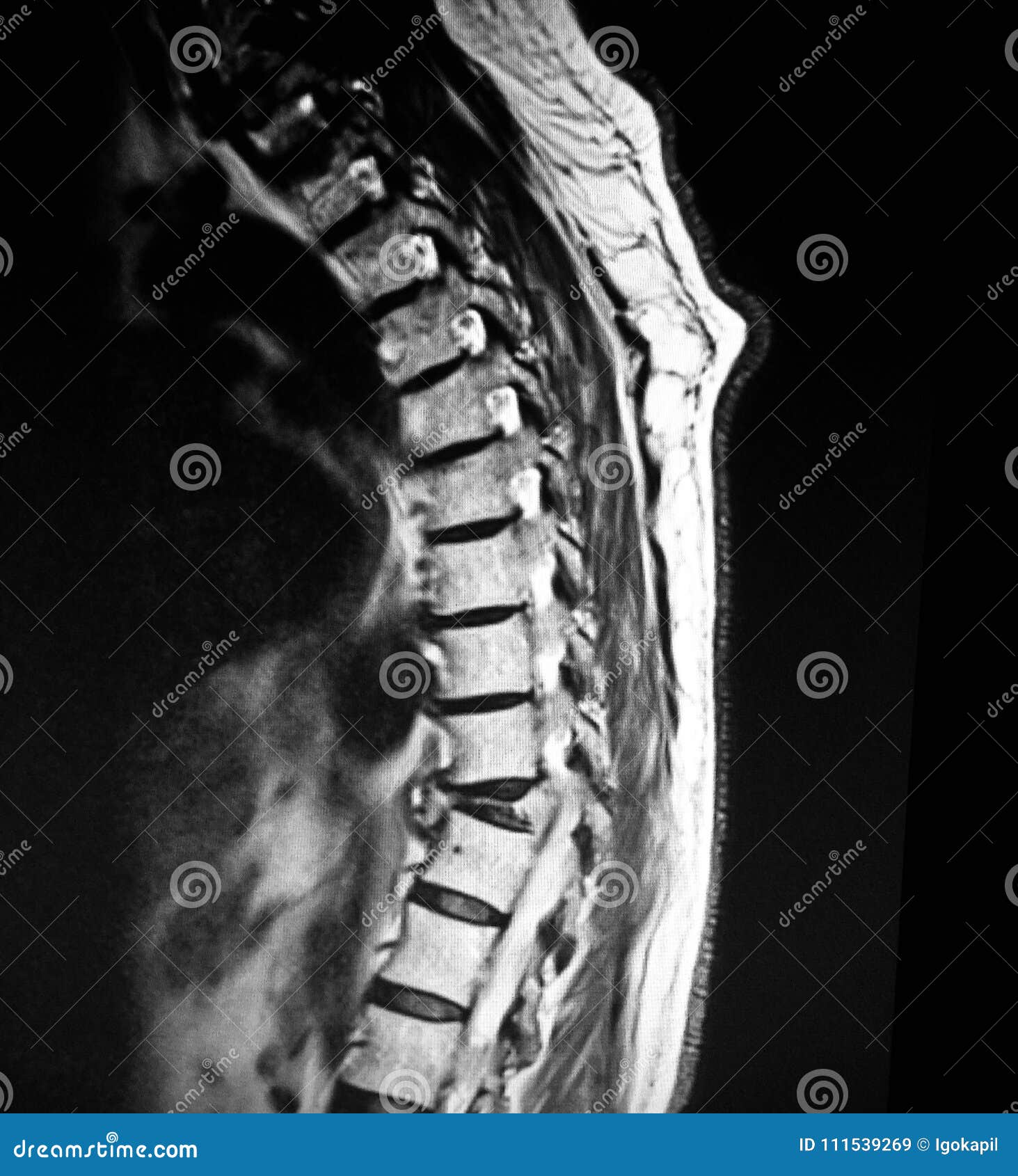 Thoracic Vertebrae Pathological Body Compression Mri Stock Image ...