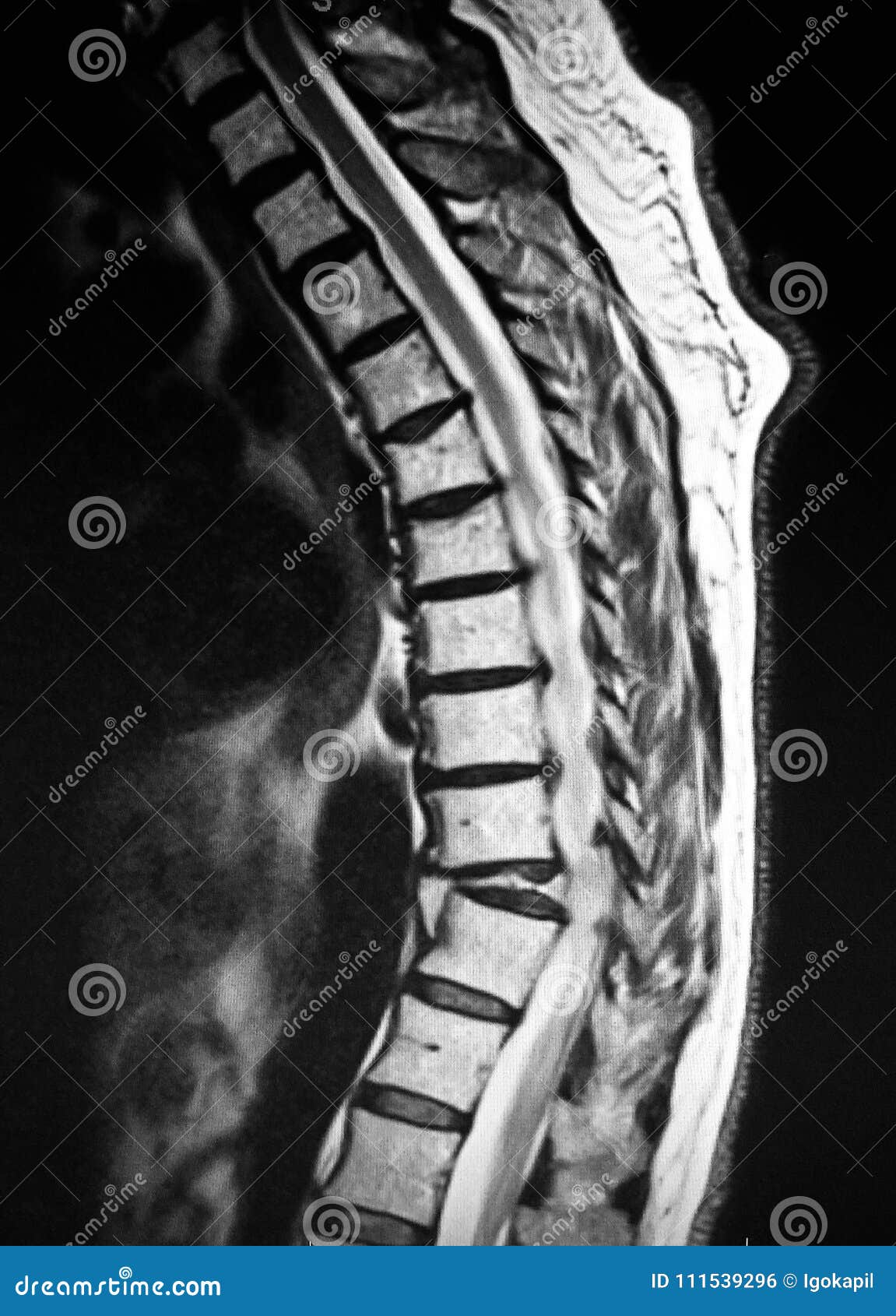 Endplate Compression Stock Photos - Free & Royalty-Free Stock Photos ...