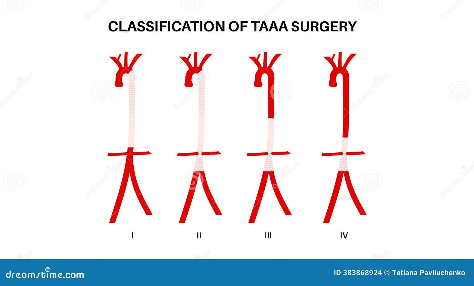 Thoracoabdominal Aortic Aneurysm Surgery Vector Illustration ...