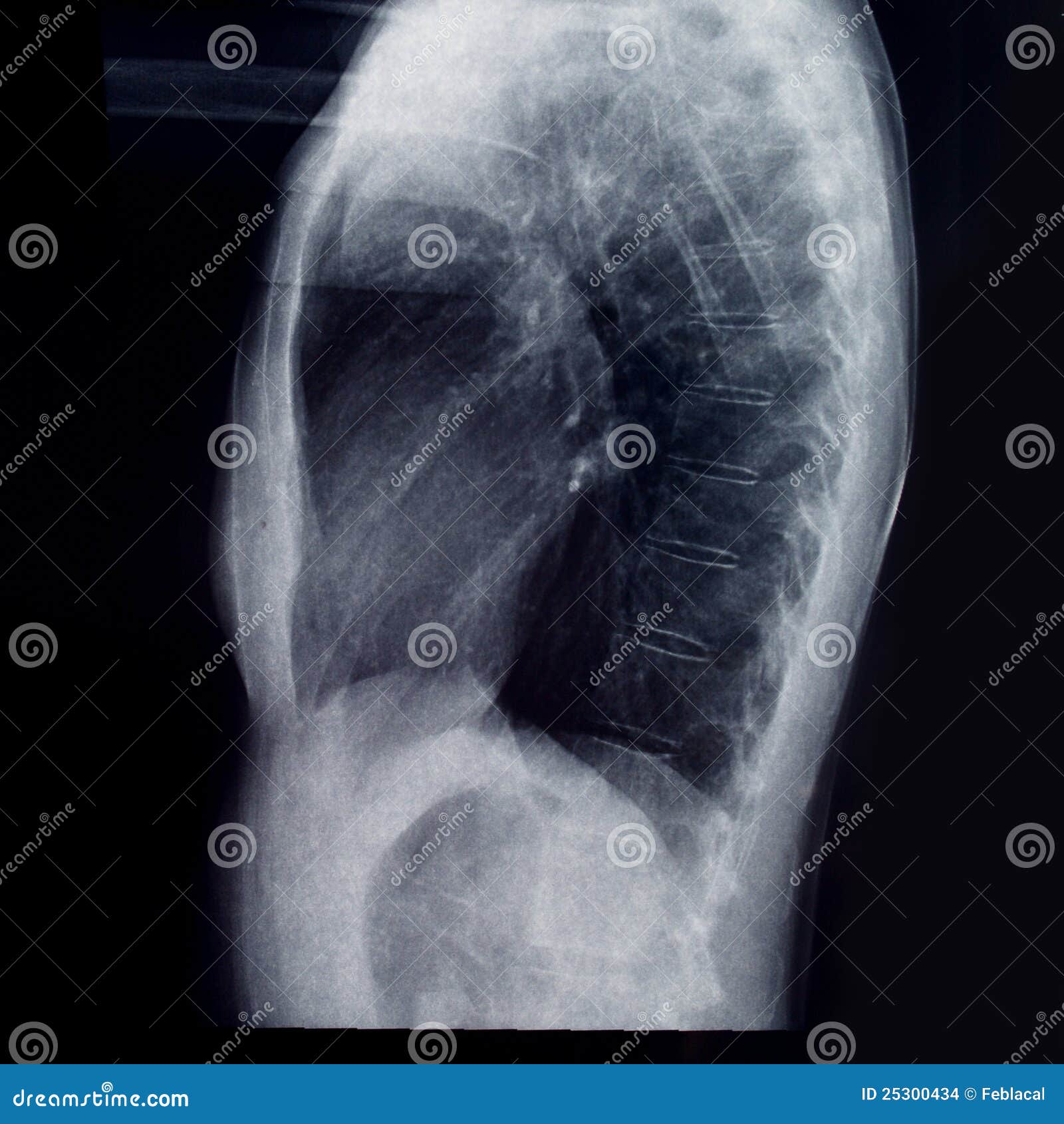 529 Thorax Radiography Photos - Free & Royalty-Free Stock Photos from ...