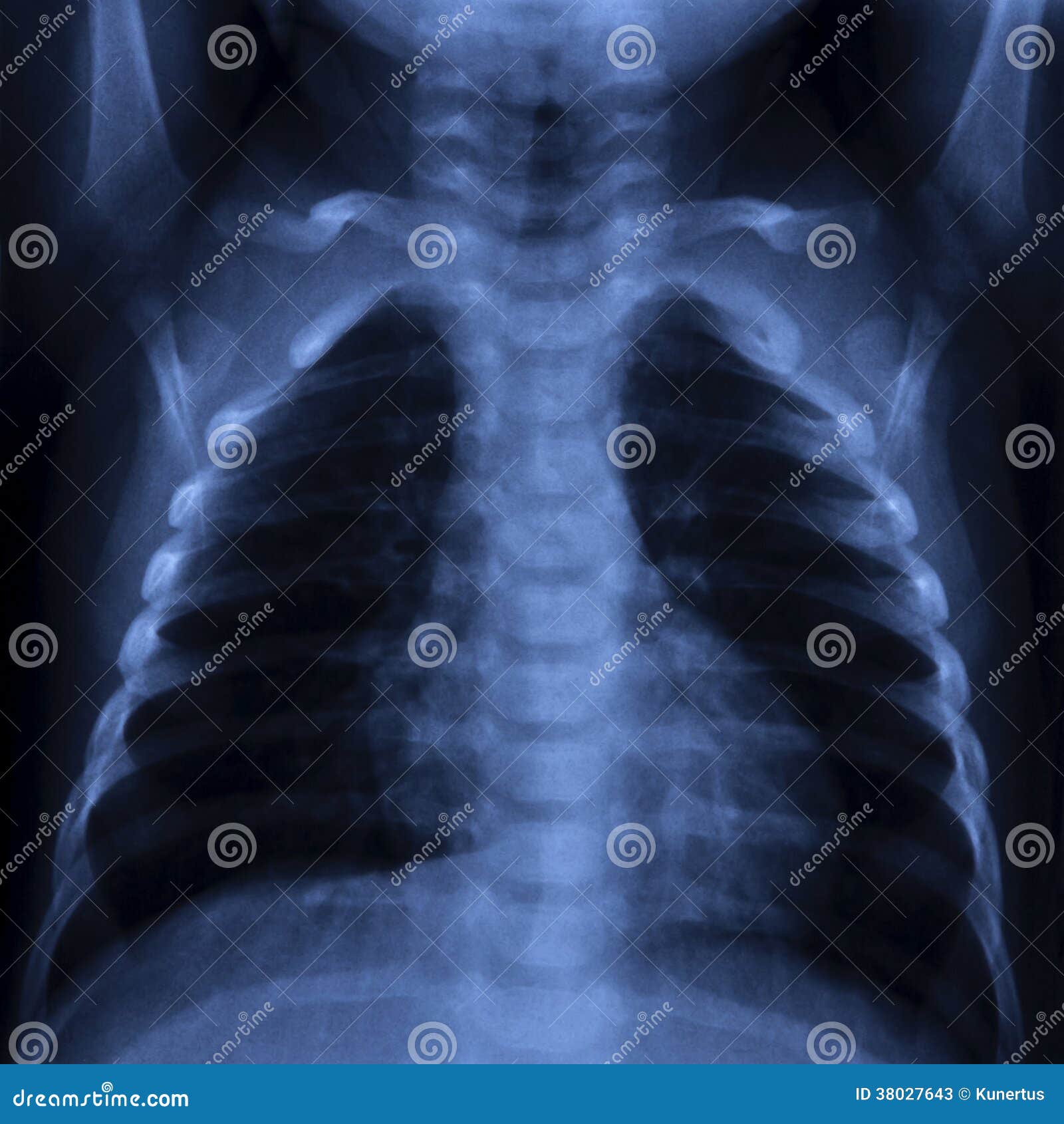 X-Ray Of Ribs And Spine Stock Image | CartoonDealer.com #46349689