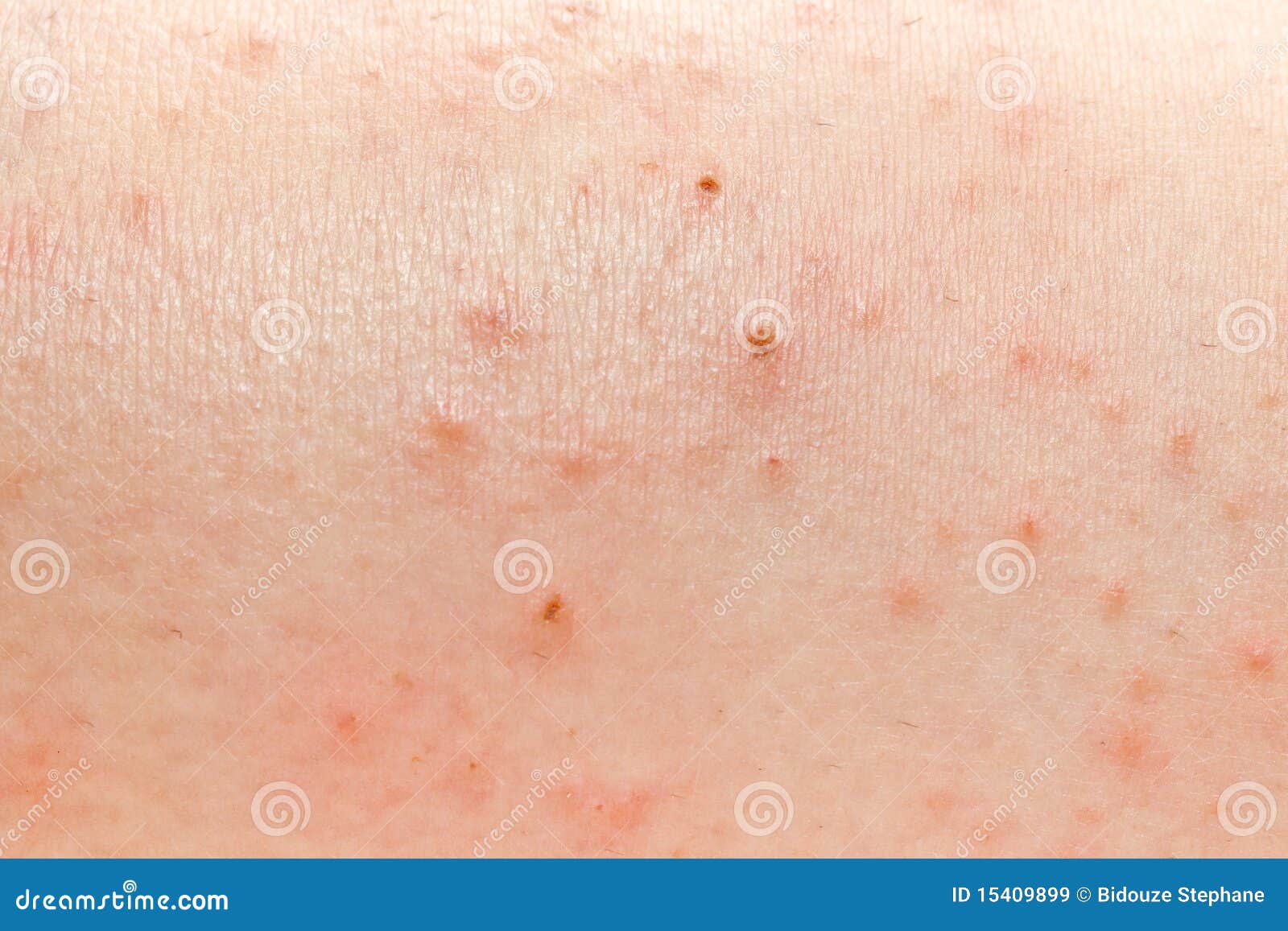 Thorn in the flesh stock image. Image of pink, human - 15409899