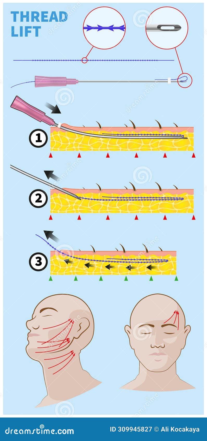 PDO THREAD LIFTING and EQUIPMENT VECTOR Stock Vector - Illustration of ...