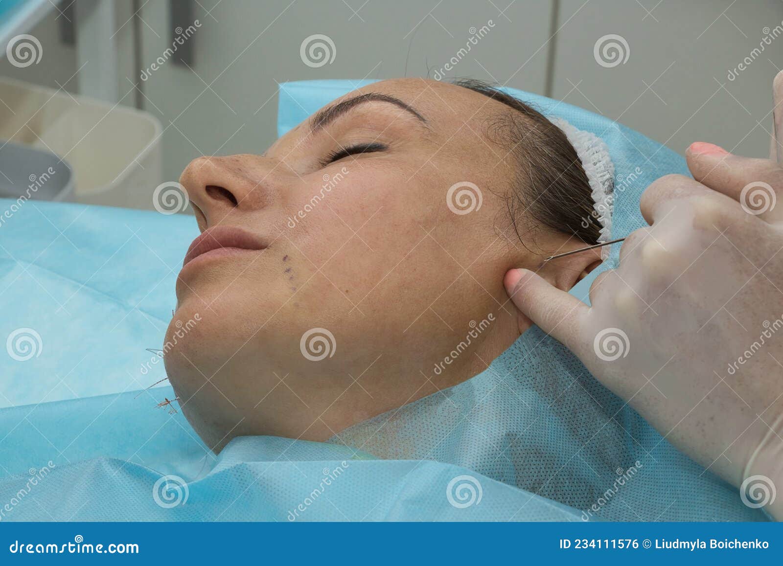 Thread Lifting of the Lower Third of the Face, Cosmetic Procedure ...