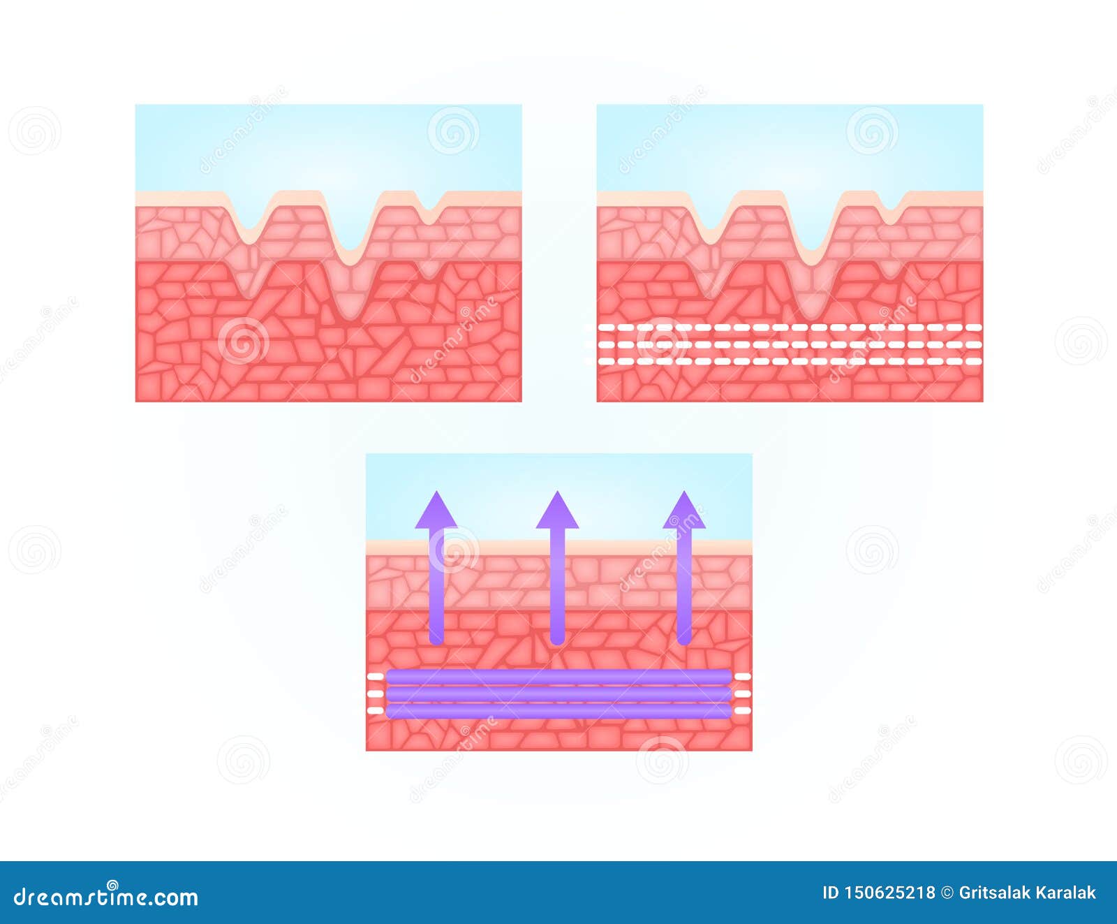 Thread lifting on skin stock vector. Illustration of collection - 150625218