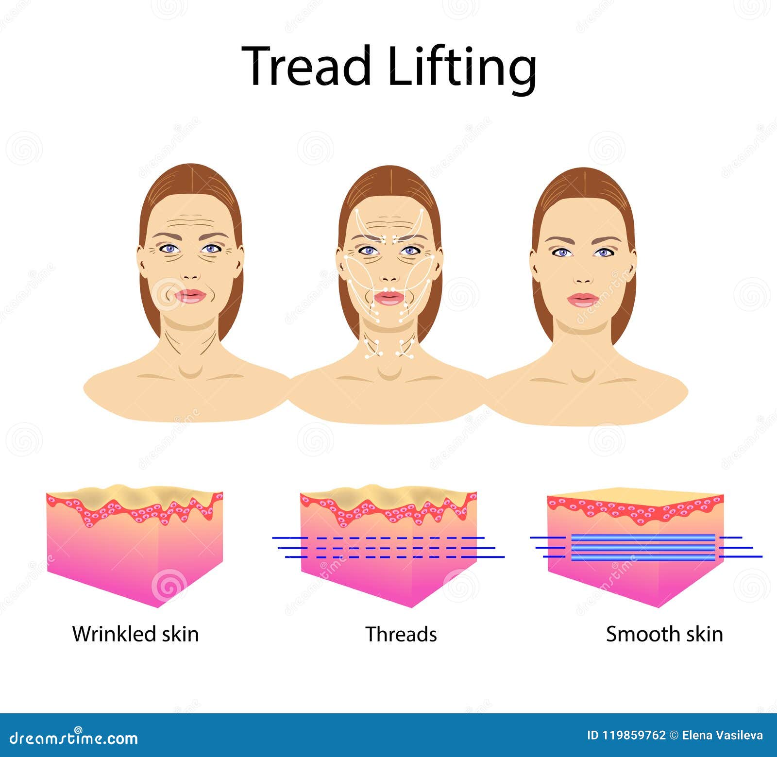 Thread Lifting, Vector Illustration, Face of a Girl Stock Vector ...