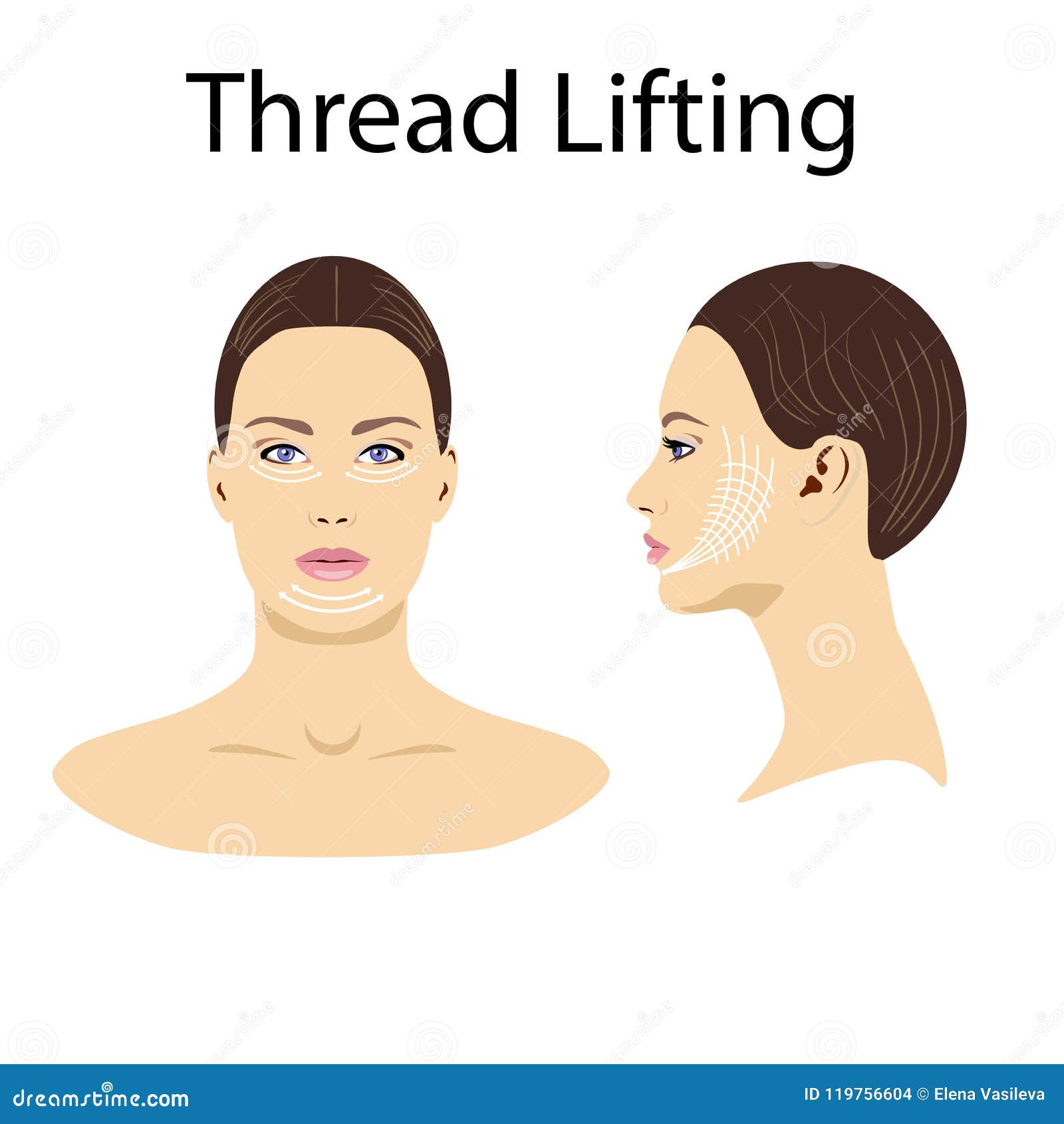 Thread Lifting, Vector Illustration And Skin Cells, Before After Effect ...