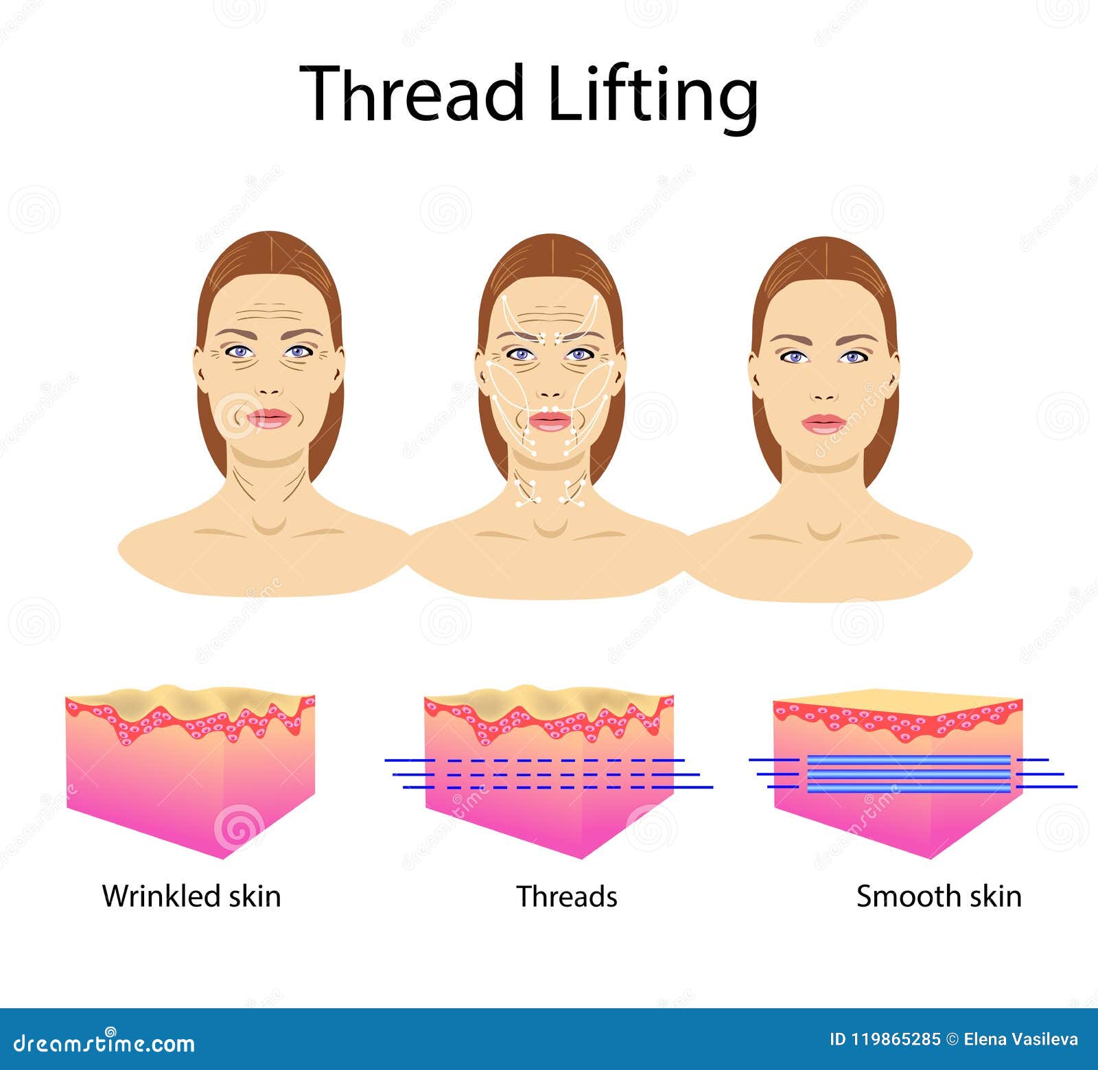 Thread Lifting, Vector Illustration, Face of a Girl Stock Vector ...