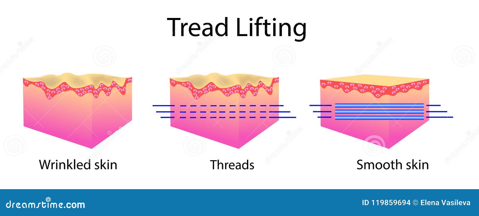 Thread Lifting, Vector Illustration and Skin Cells, before after Effect ...