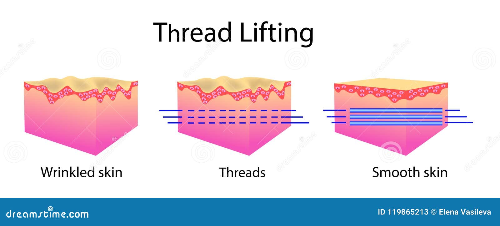 Thread Lifting, Vector Illustration And Skin Cells, Before After Effect ...