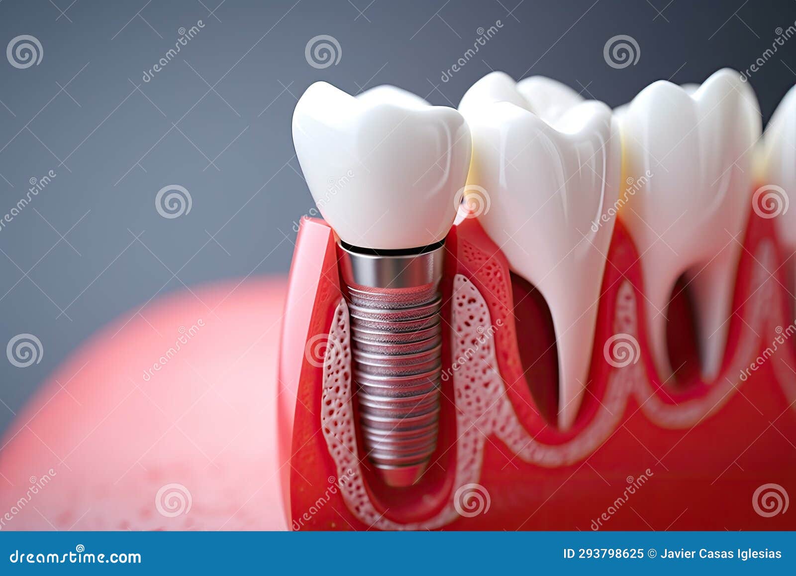 A Model of a Tooth with an Implant Model Stock Illustration ...