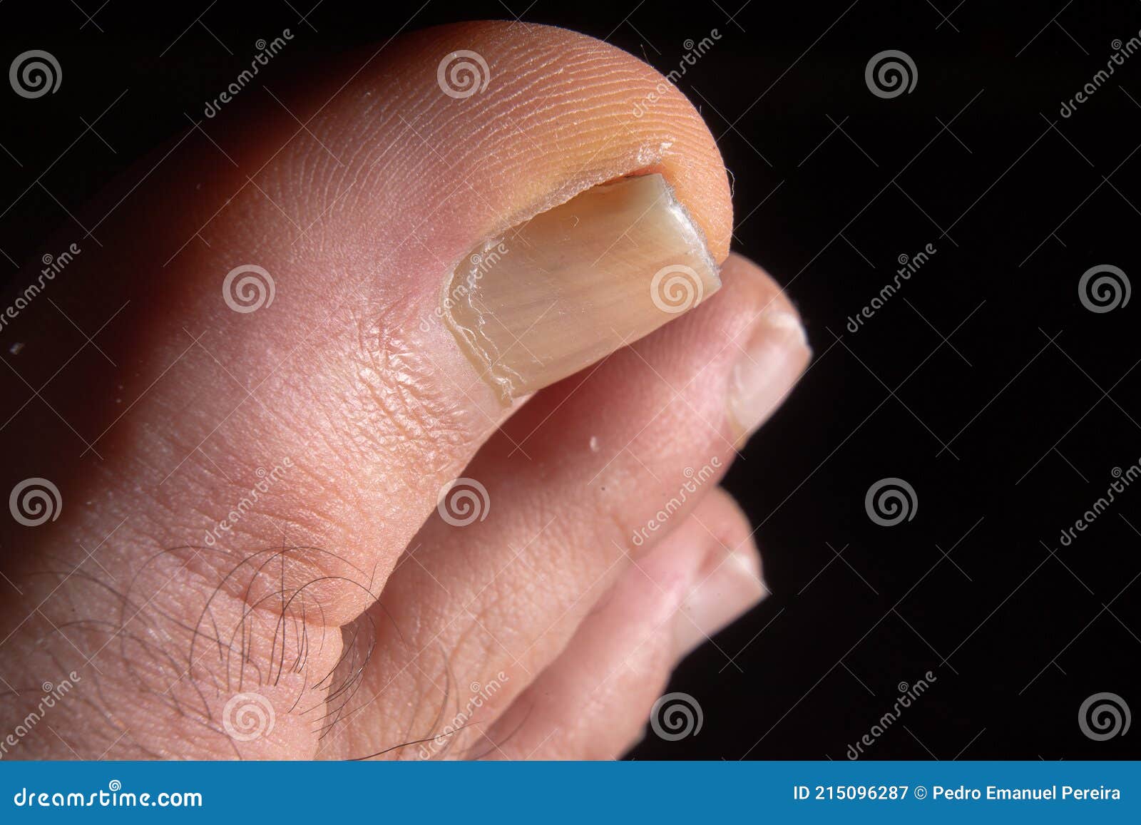 Three Human Toes With Illumination On The Right Side Under Black ...