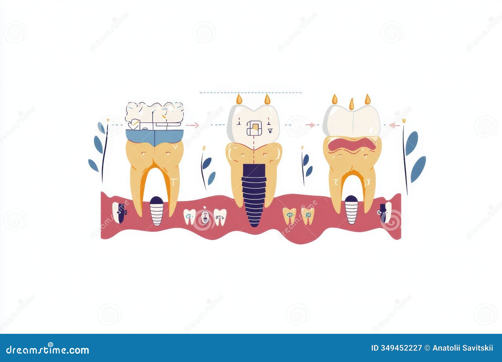 Three-stage Visual of the Dental Implant Process: Placement, Final ...