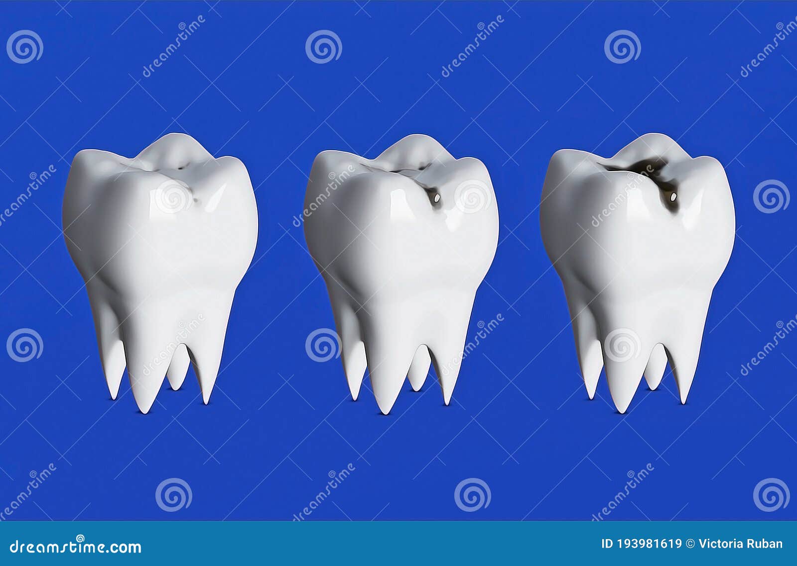 Three Teeth In Ginival With Staples Stock Photo | CartoonDealer.com ...