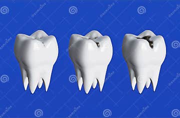 Three Teeth in a Row, Three Stages of Tooth Decay Stock Illustration ...