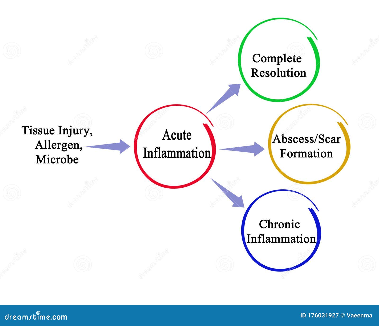 Ways of Resolution of Acute Inflammation Stock Illustration ...
