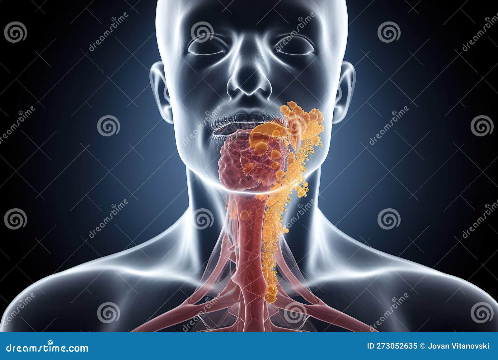 Throat Infected with Mononucleosis Created by Generative AI Stock ...