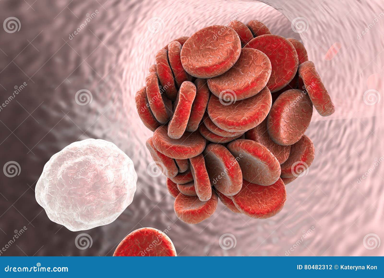 Thromboembol Dans Le Vaisseau Sanguin Illustration Stock - Illustration ...