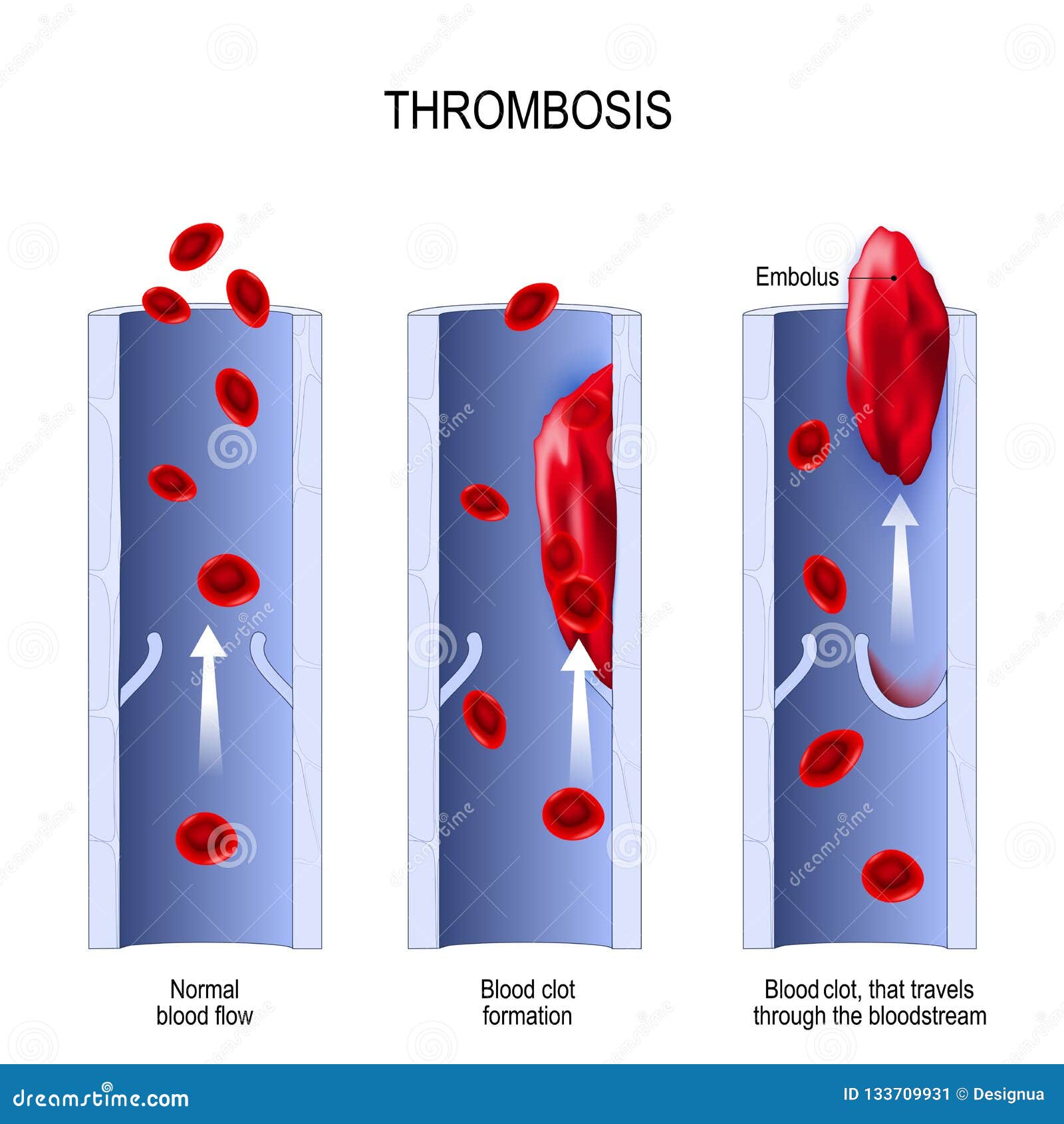 Thrombose embolisme illustration de vecteur. Illustration du ...
