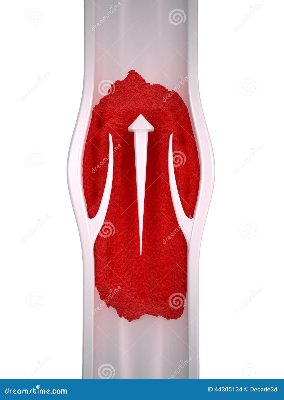 Thrombus Cartoon Vector | CartoonDealer.com #40644175