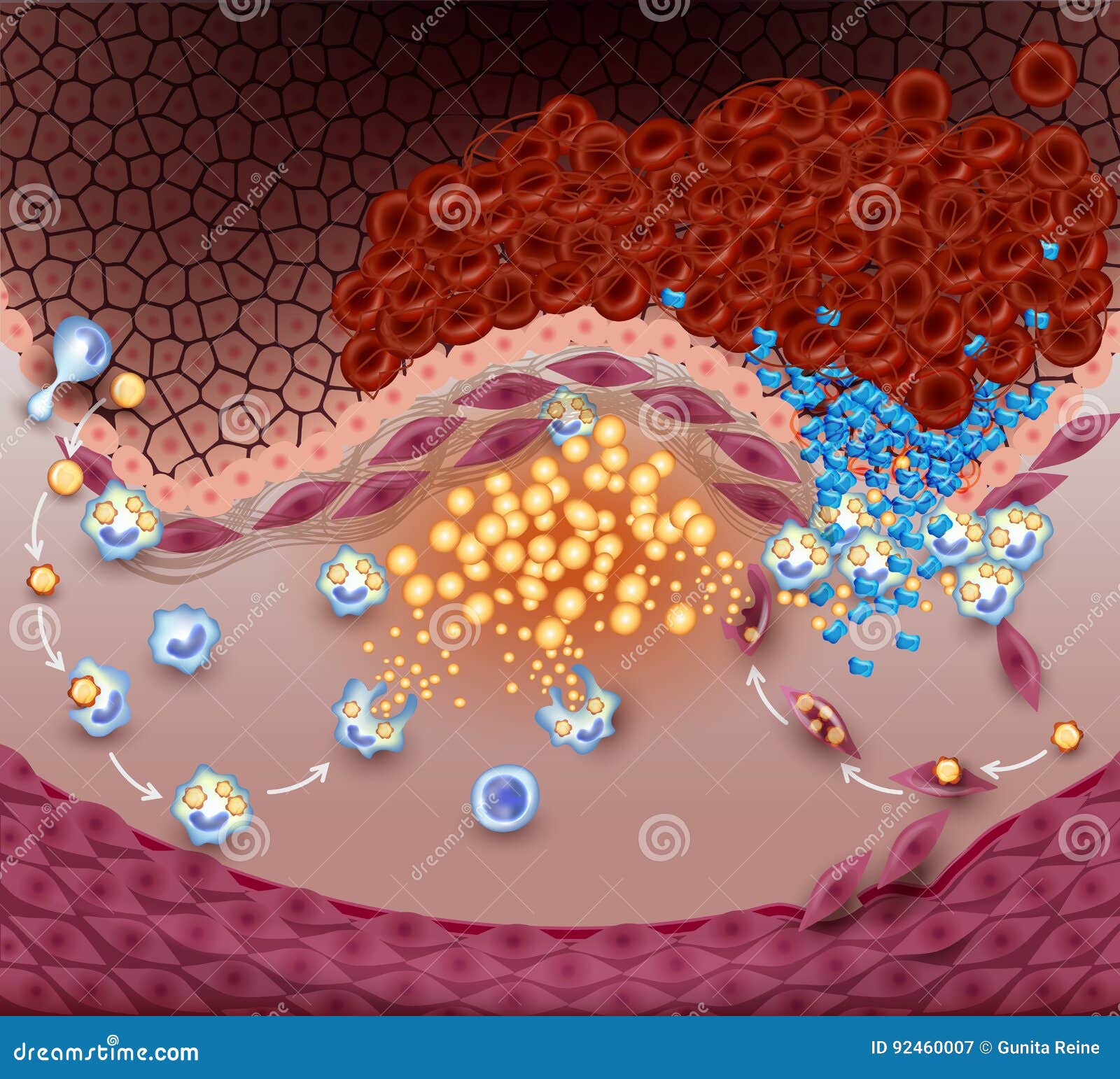 Thrombus, caillot sanguin illustration de vecteur. Illustration du ...