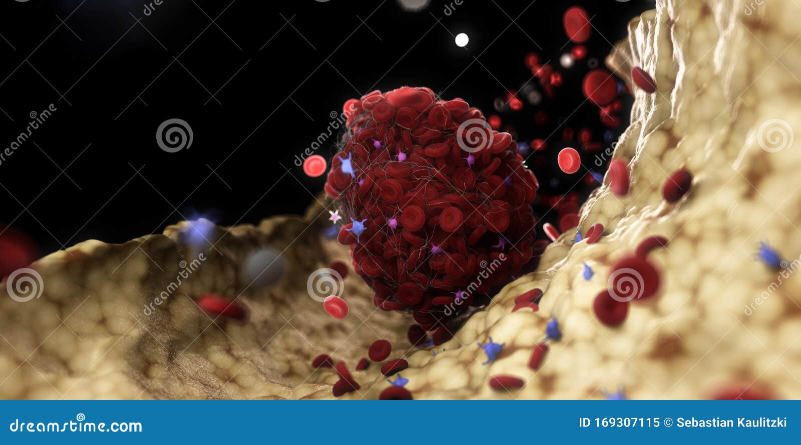 Thrombus Cartoon Vector | CartoonDealer.com #40644175
