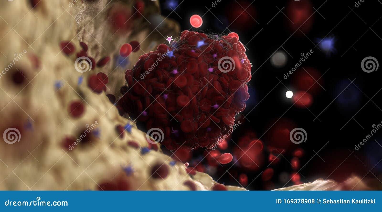 Thrombus Cartoon Vector | CartoonDealer.com #40644175