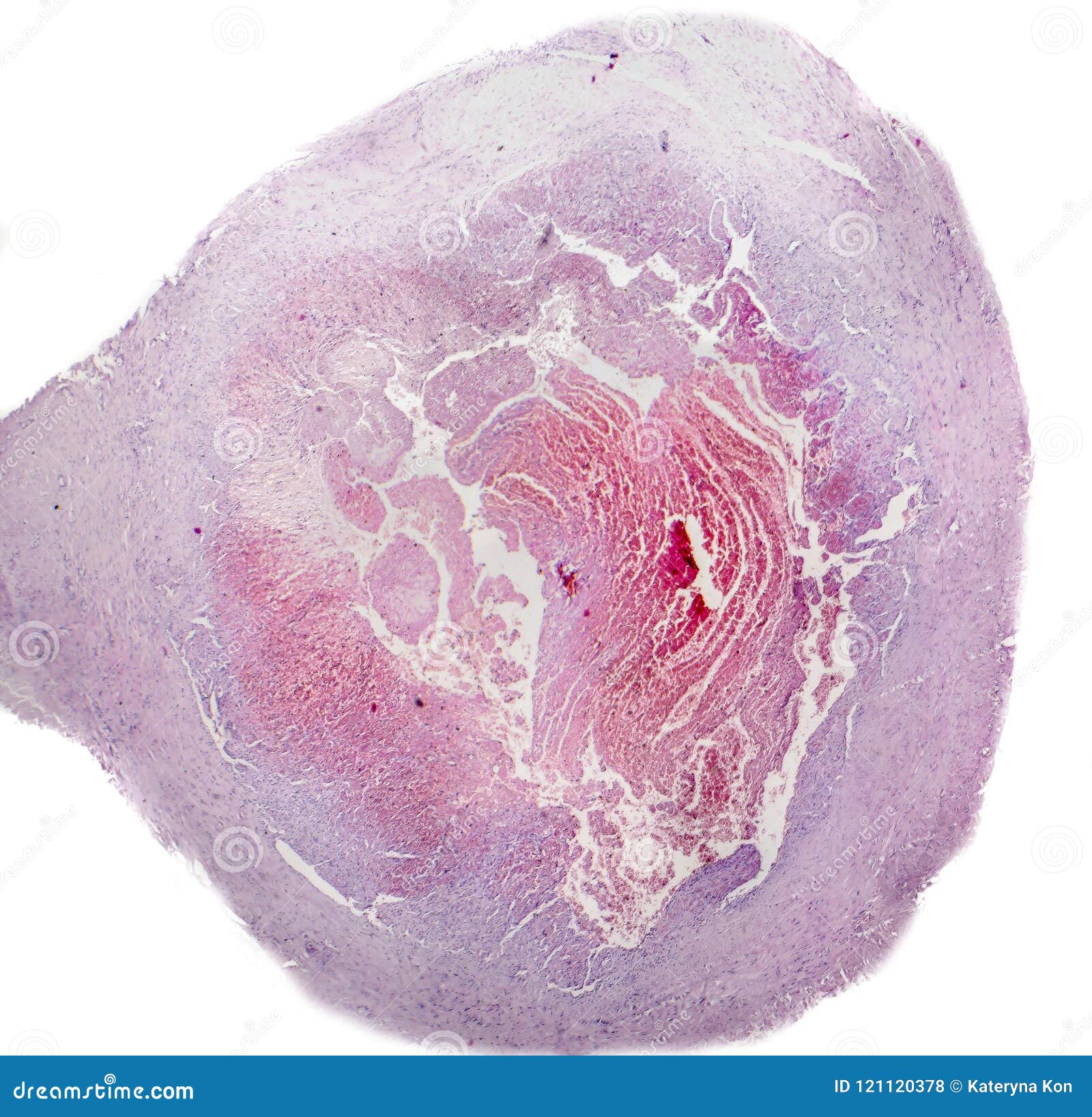 Thrombus Inside Vein, Light Micrograph Stock Photo - Image of ...