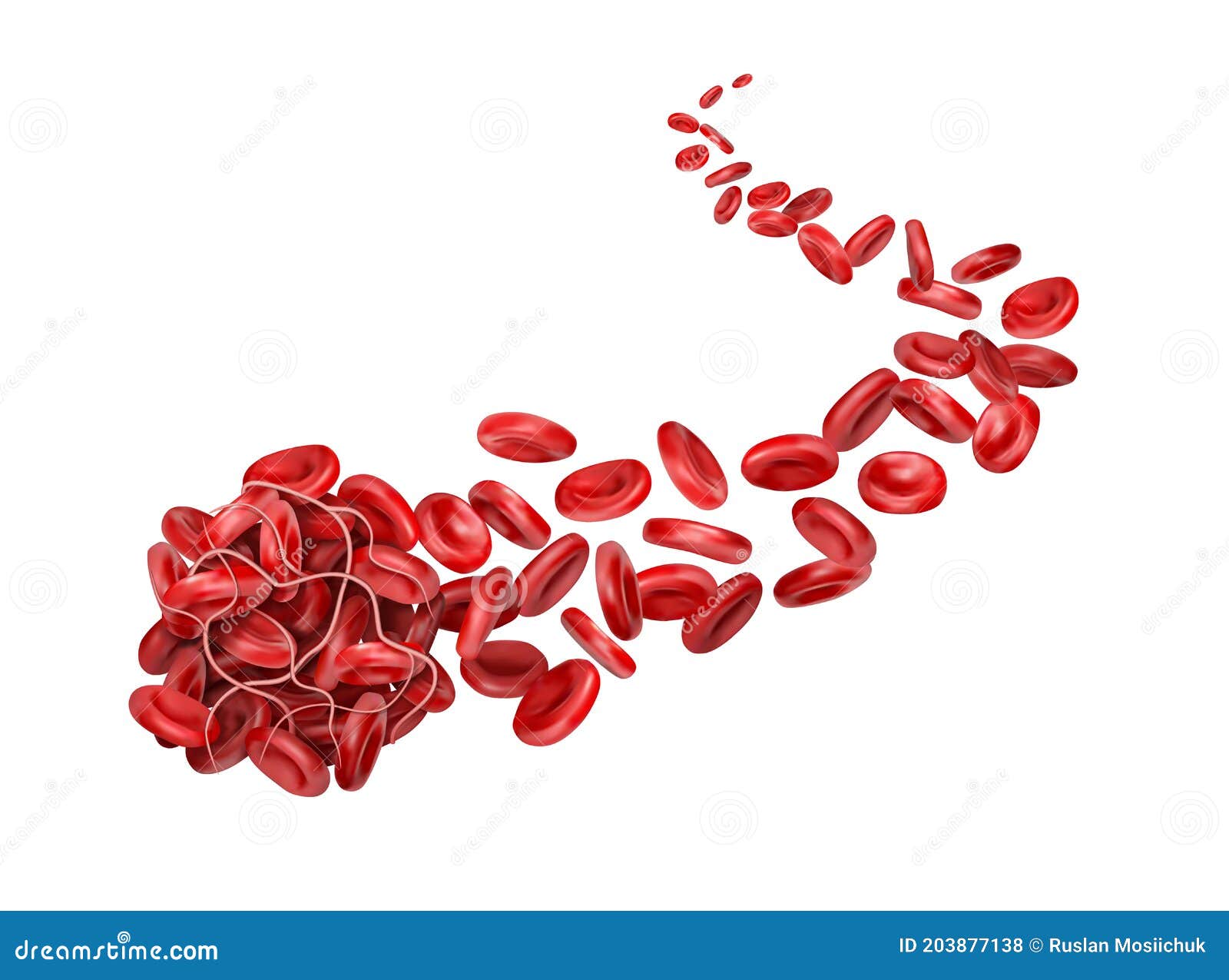 Thrombus, Blood Clot, Unstable Plaque Cartoon Vector | CartoonDealer ...