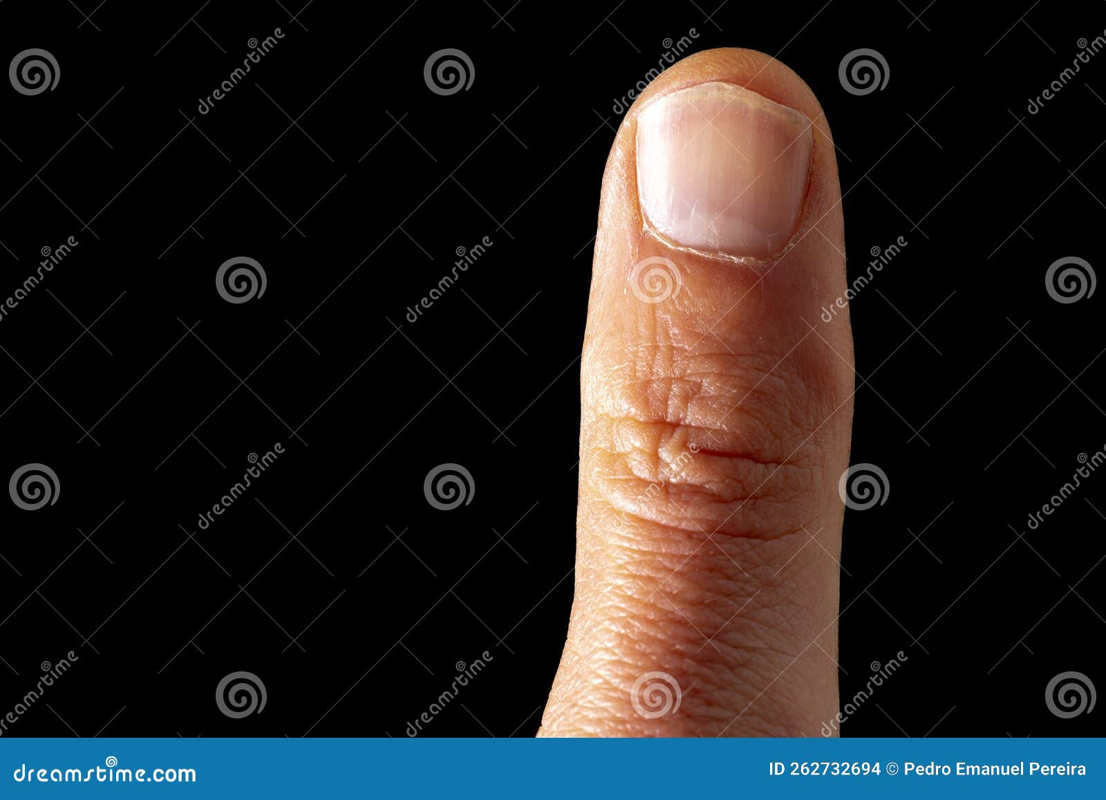 Thumb of Human Hand with Nail Bitten by Teeth Under Black Background ...