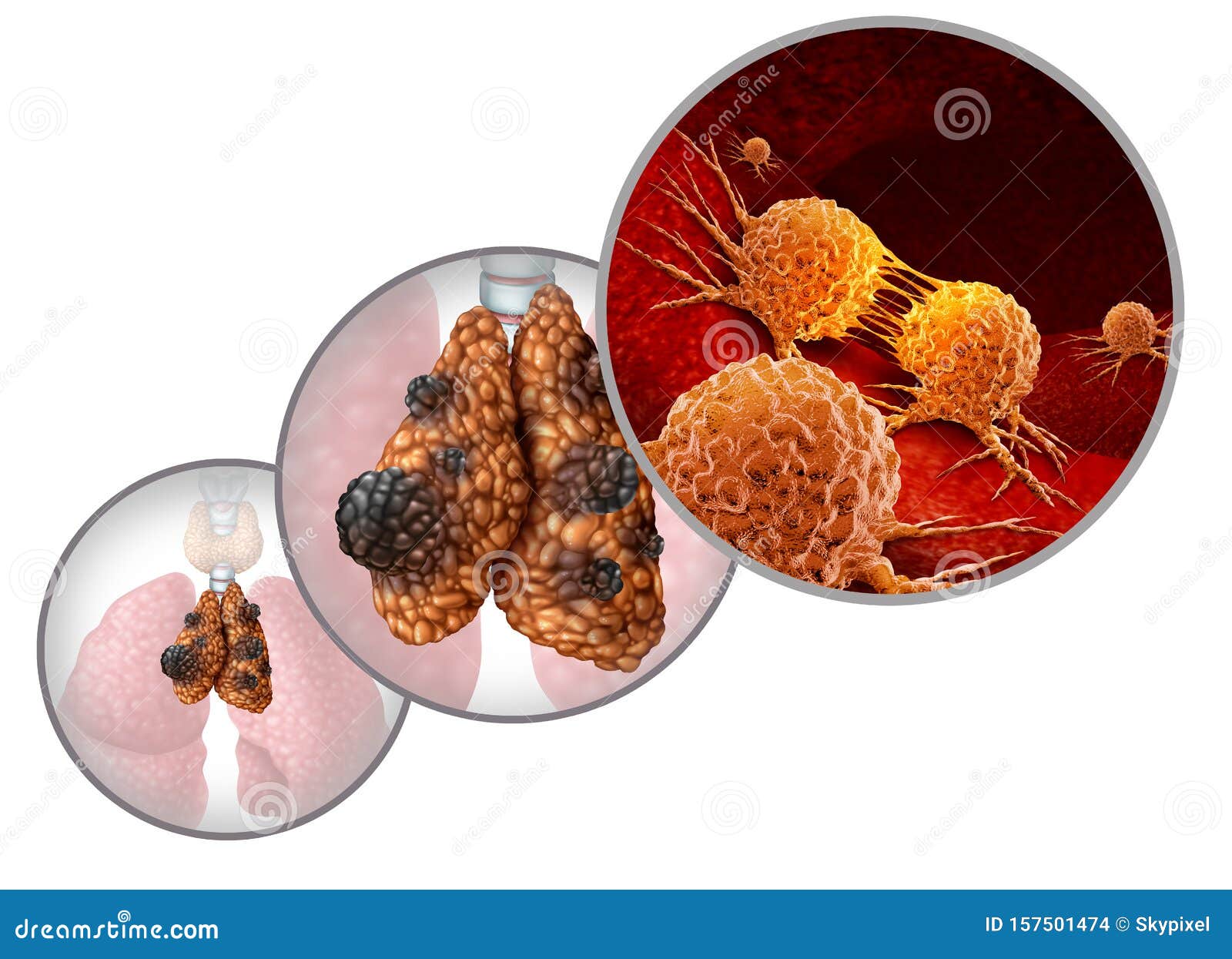 Thymus Cancer Disease Stock Illustration Illustration Of Background 157501474
