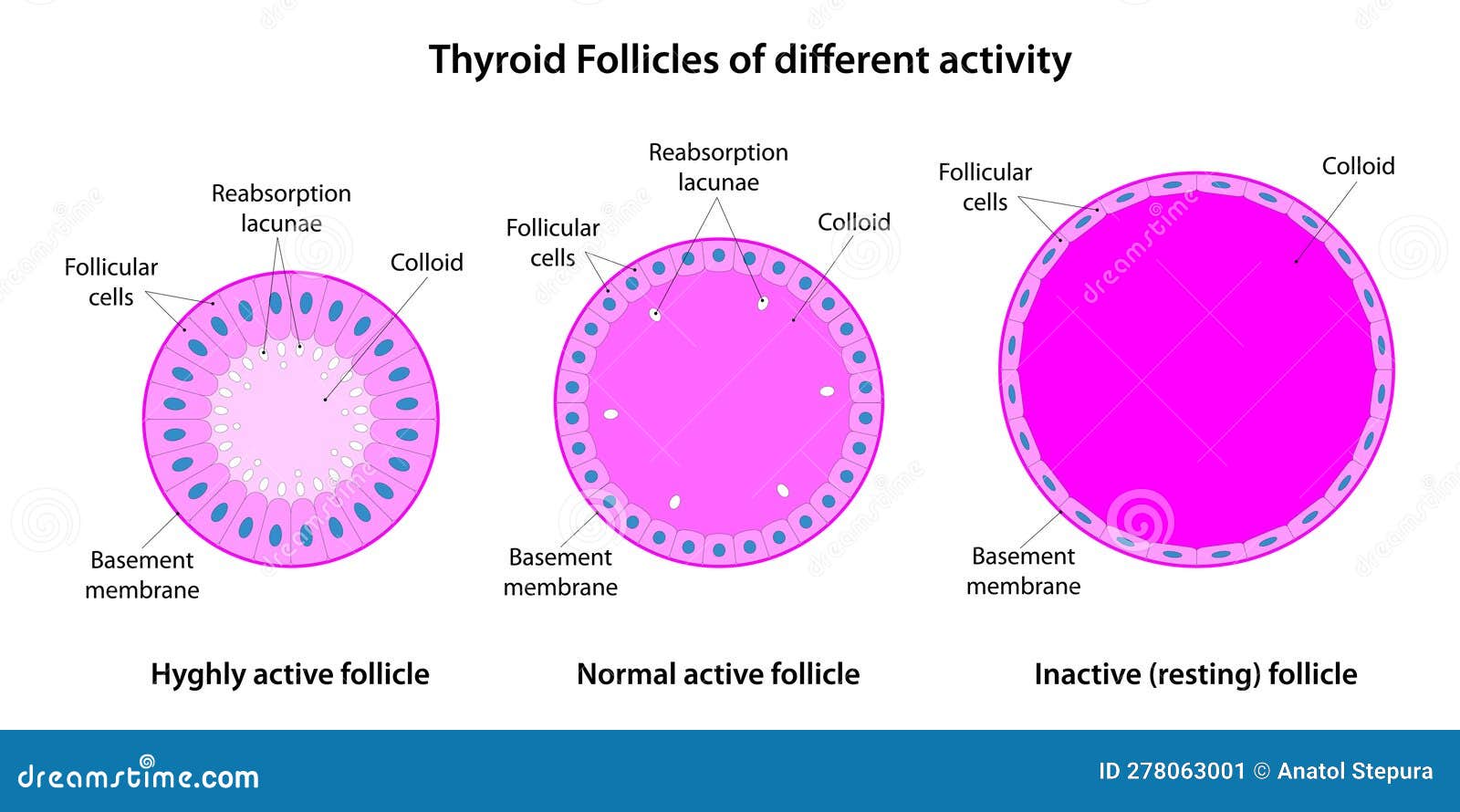 Thyroid Follicles Of Different Activity Hyghly Normal And Inactive