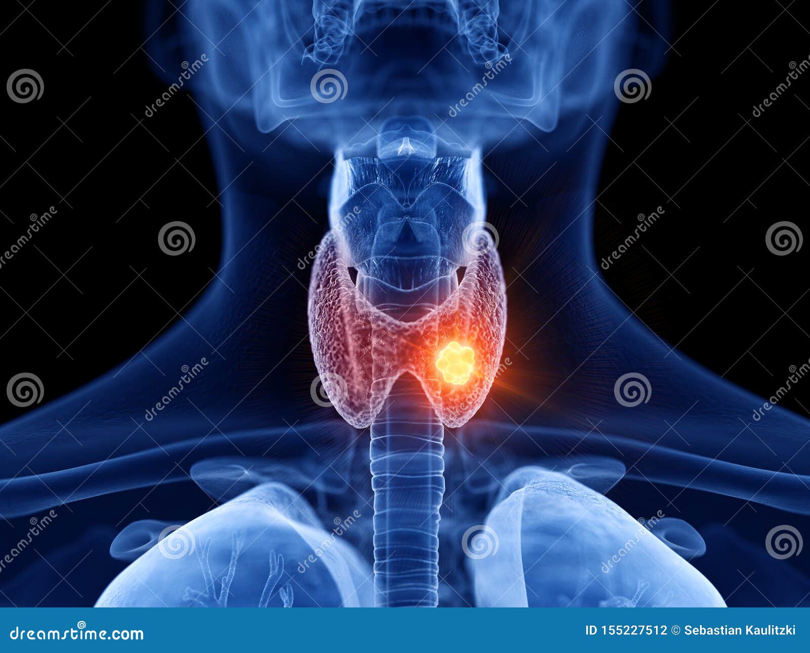 Thyroid Cancer 3d Medical Illustration With Nymph Nodes On White ...