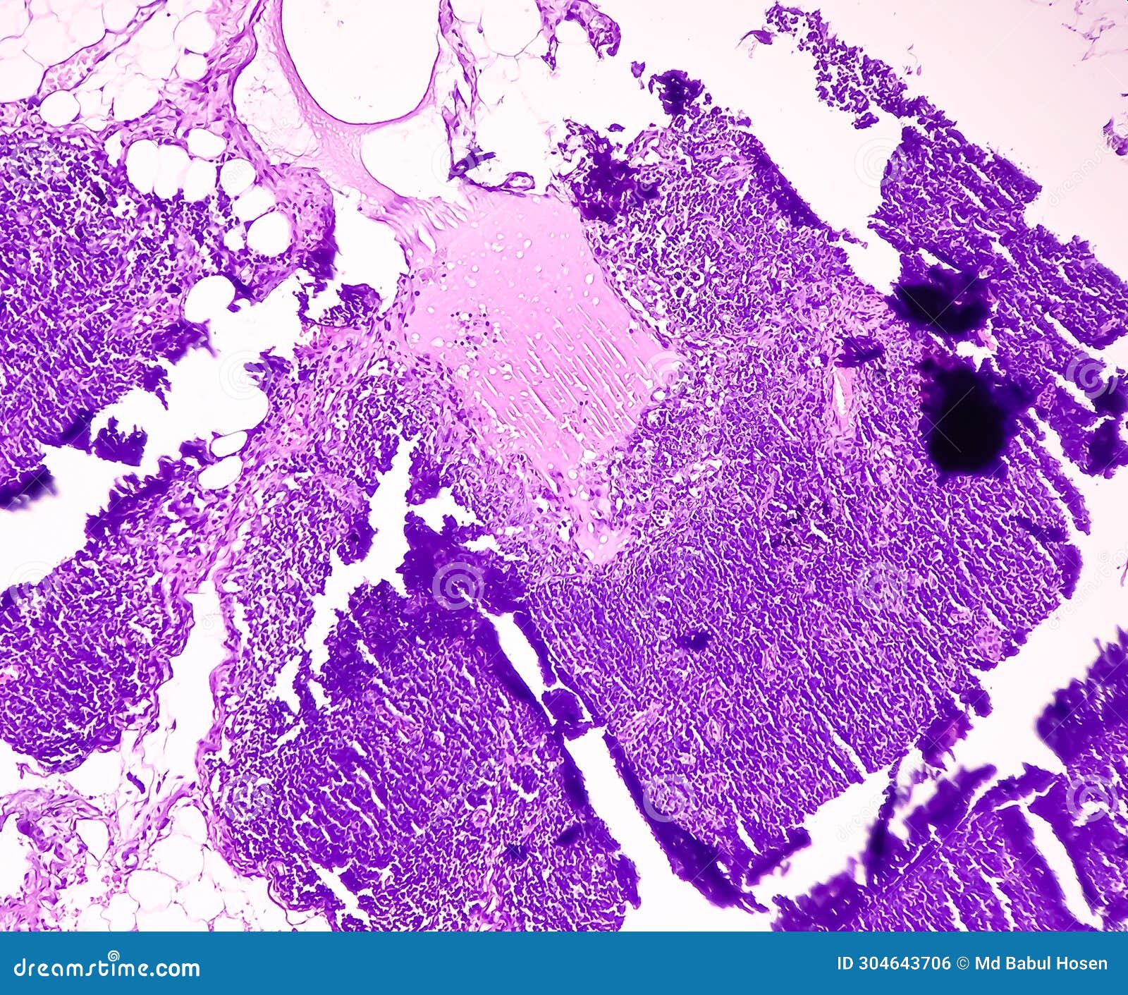 Thyroid Cancer Tracheal Gland Involved By Tumor Metastatic Papillary Carcinoma Of Thyroid