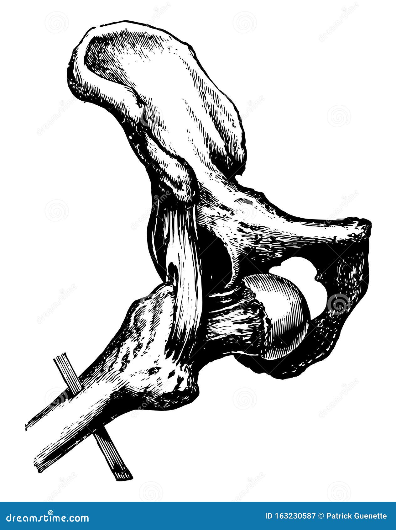 Hip Dislocation Illustration Cartoon Vector | CartoonDealer.com #258914749