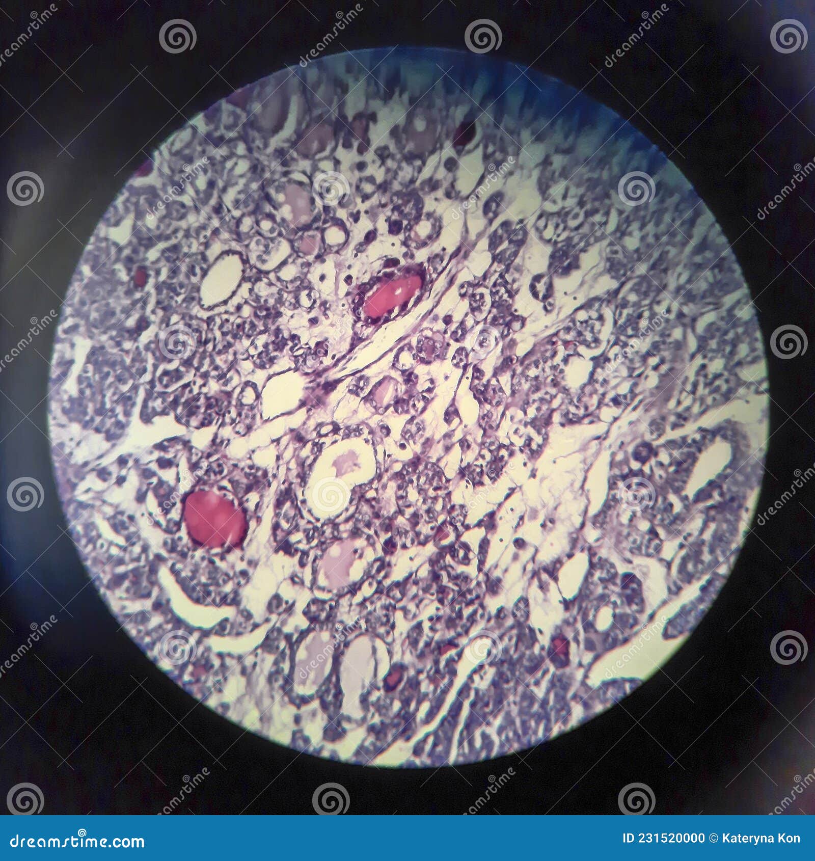 Thyroid Follicular Carcinoma, Light Micrograph Royalty-Free Stock ...