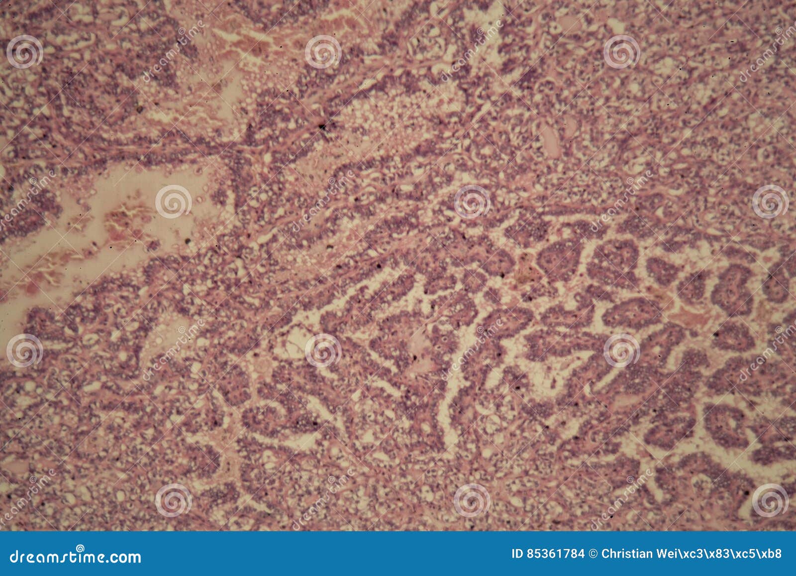 Thyroid Gland Cells with Cancer Stock Photo - Image of cancer, biopsy ...