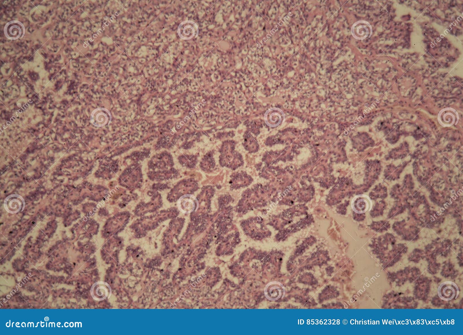Thyroid Gland Cells with Cancer Stock Photo - Image of laboratory ...